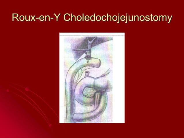 Rtc extrahepatic billiary injury | PPT