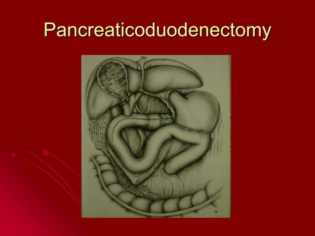Rtc extrahepatic billiary injury | PPT