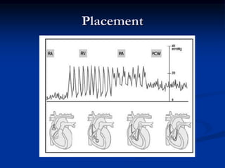 RTC PA CATHETER.ppt