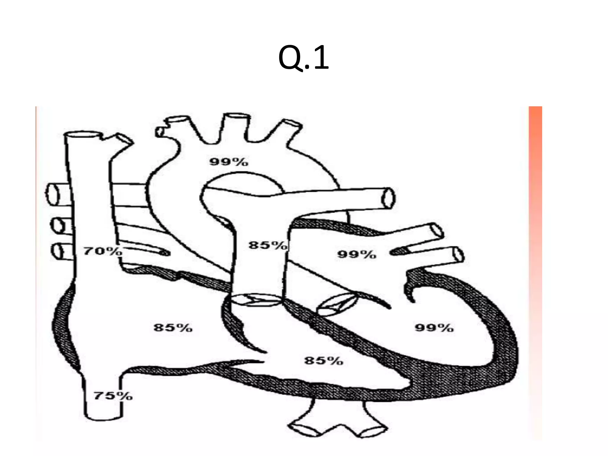 Right heart catheterization | PPSX