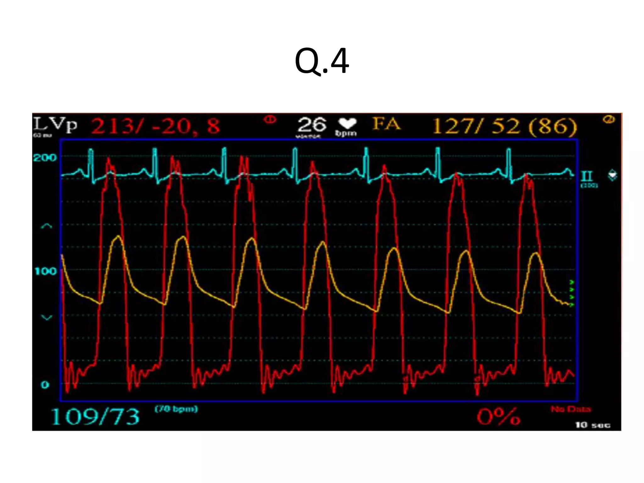 Right heart catheterization | PPSX