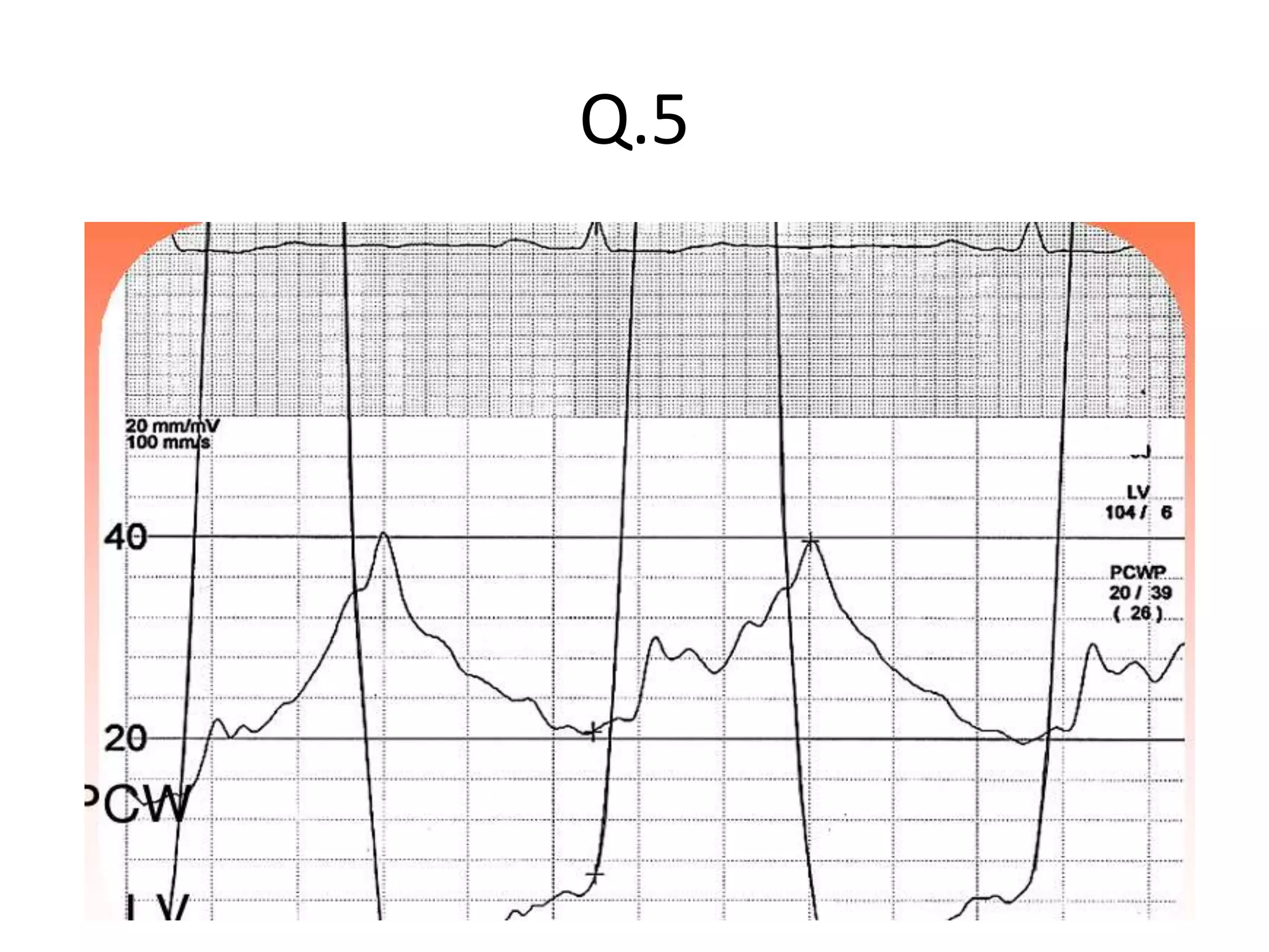 Right heart catheterization | PPSX