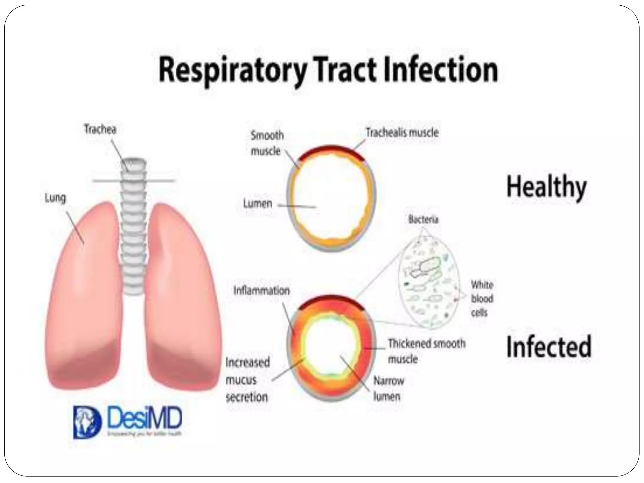 Respiratory Tract Infections | PPTX | Ear, Nose and Throat Conditions ...
