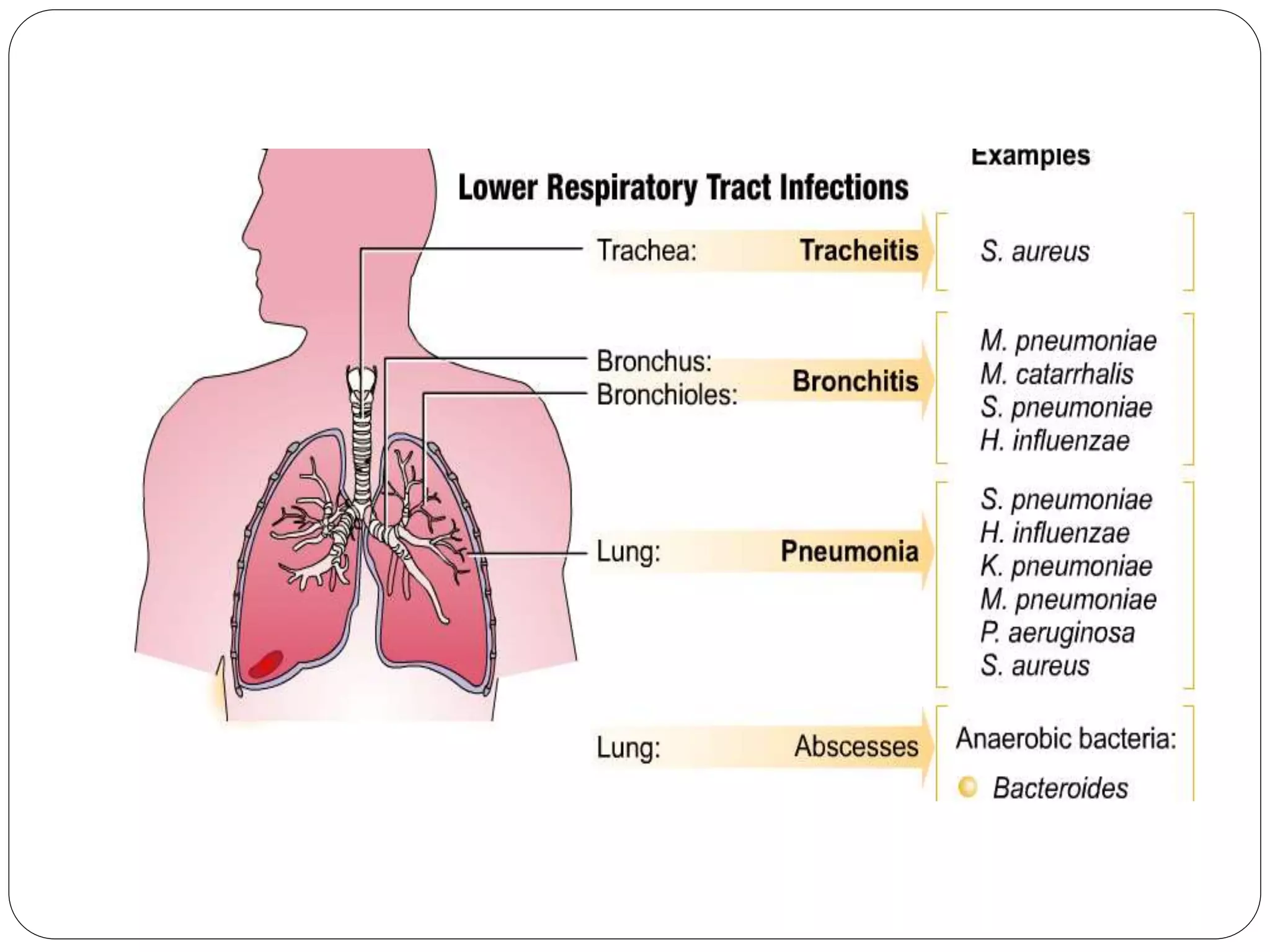 Respiratory Tract Infections | PPTX