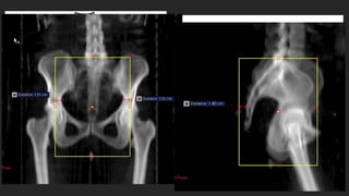 Radiotherapy planning in carcinoma of rectum | PPTX