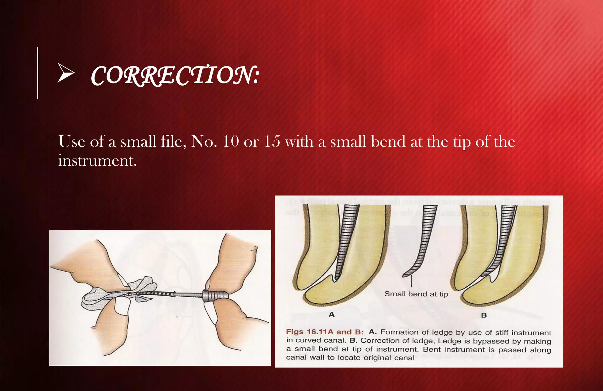 Endodontic mishaps during RCT | PDF