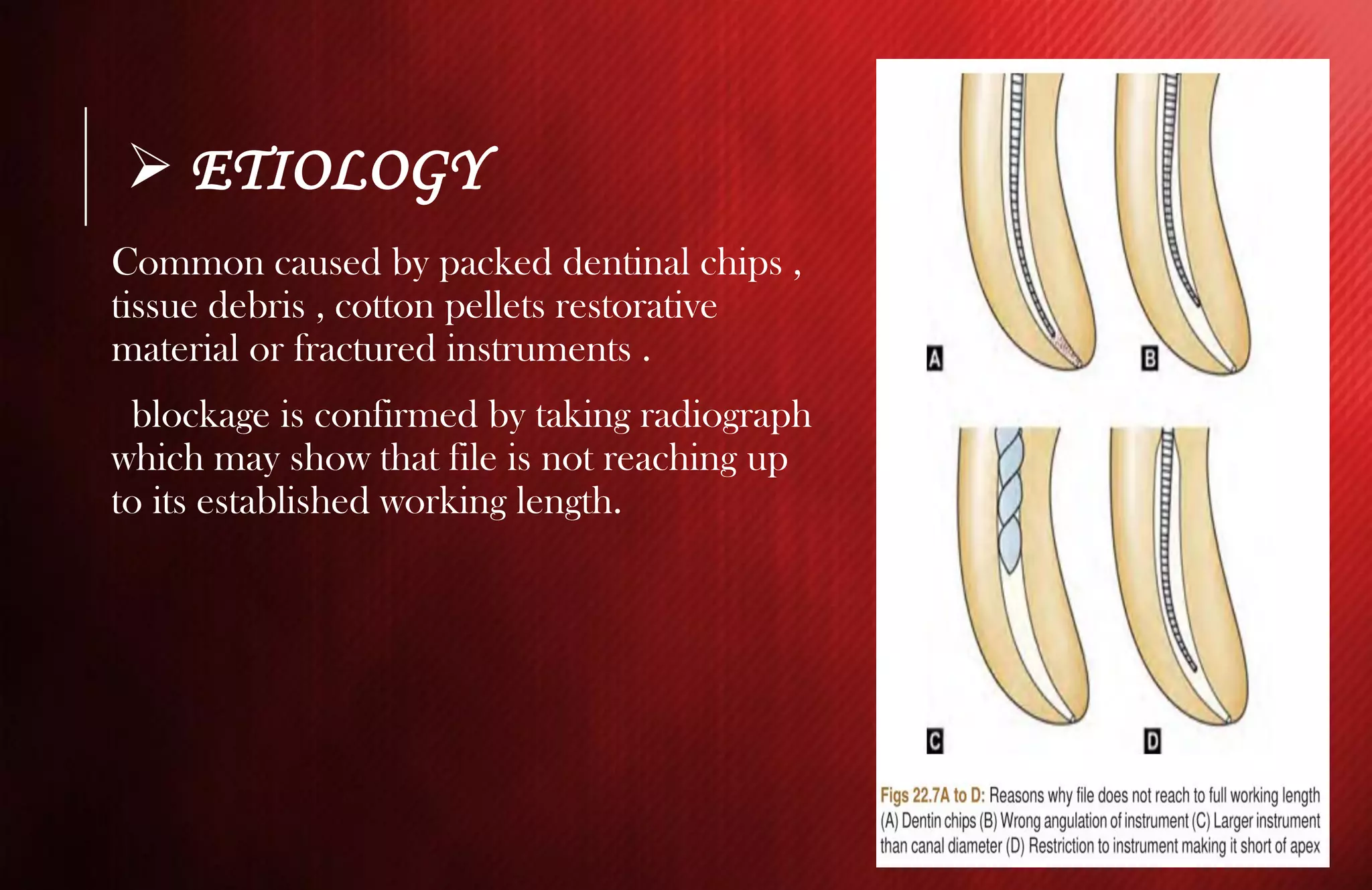 Endodontic mishaps during RCT | PDF | Dental Health | Diseases and ...