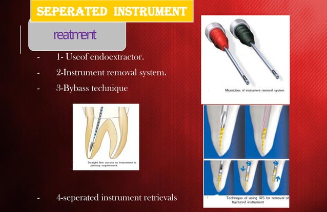 Endodontic mishaps during RCT | PDF | Dental Health | Diseases and ...