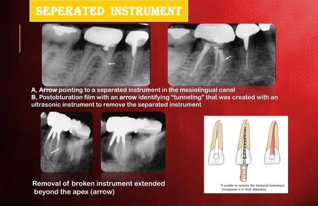 Endodontic mishaps during RCT | PPT