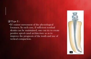 Endodontic mishaps during RCT | PDF
