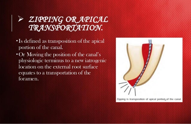 Endodontic mishaps during RCT