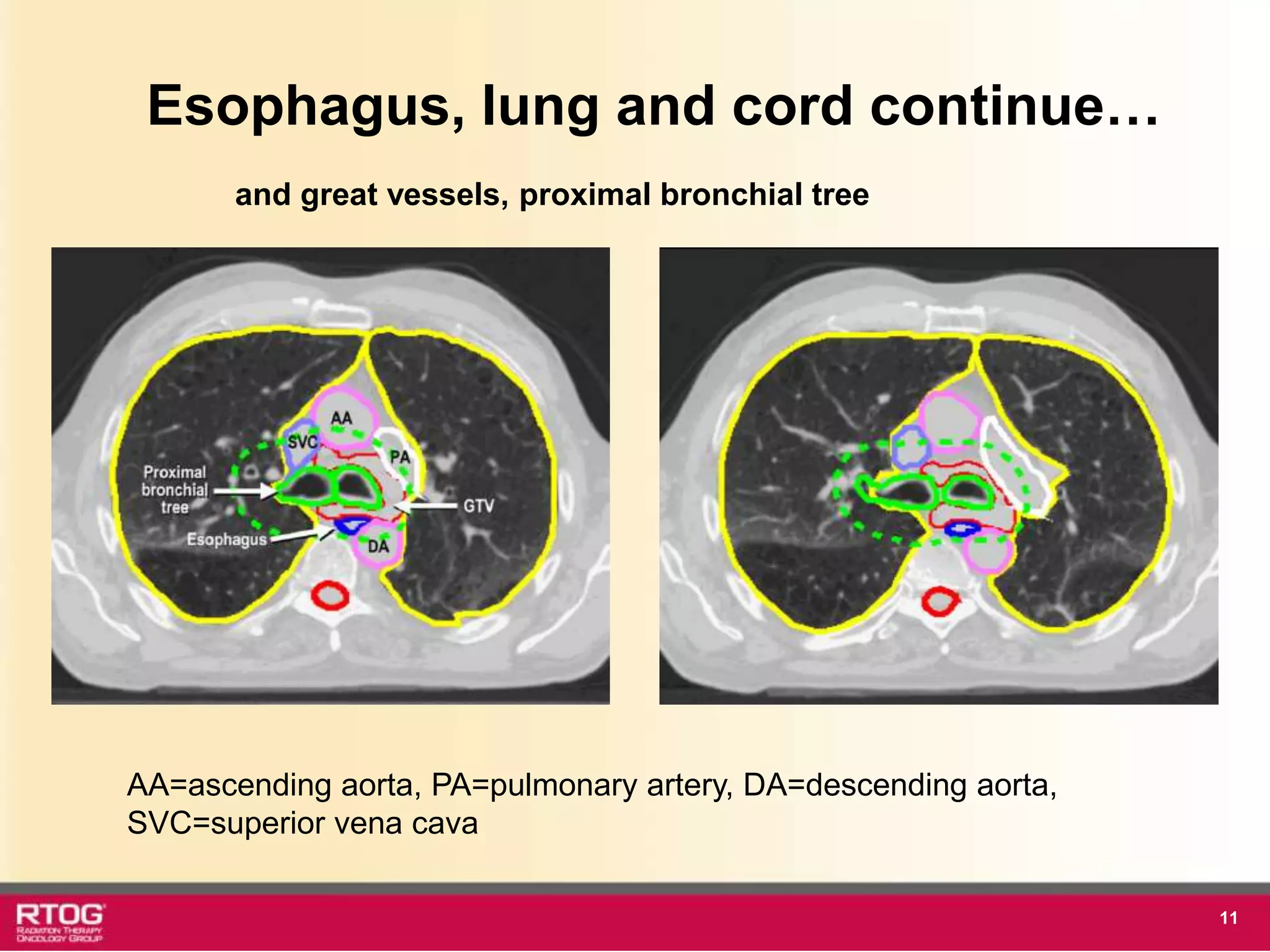 RTOG 1106 OAR Atlas Thoracic Radiation Therapy.ppt
