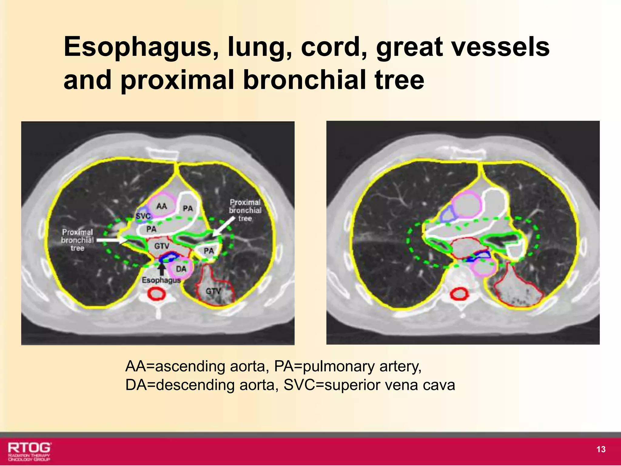 RTOG 1106 OAR Atlas Thoracic Radiation Therapy.ppt