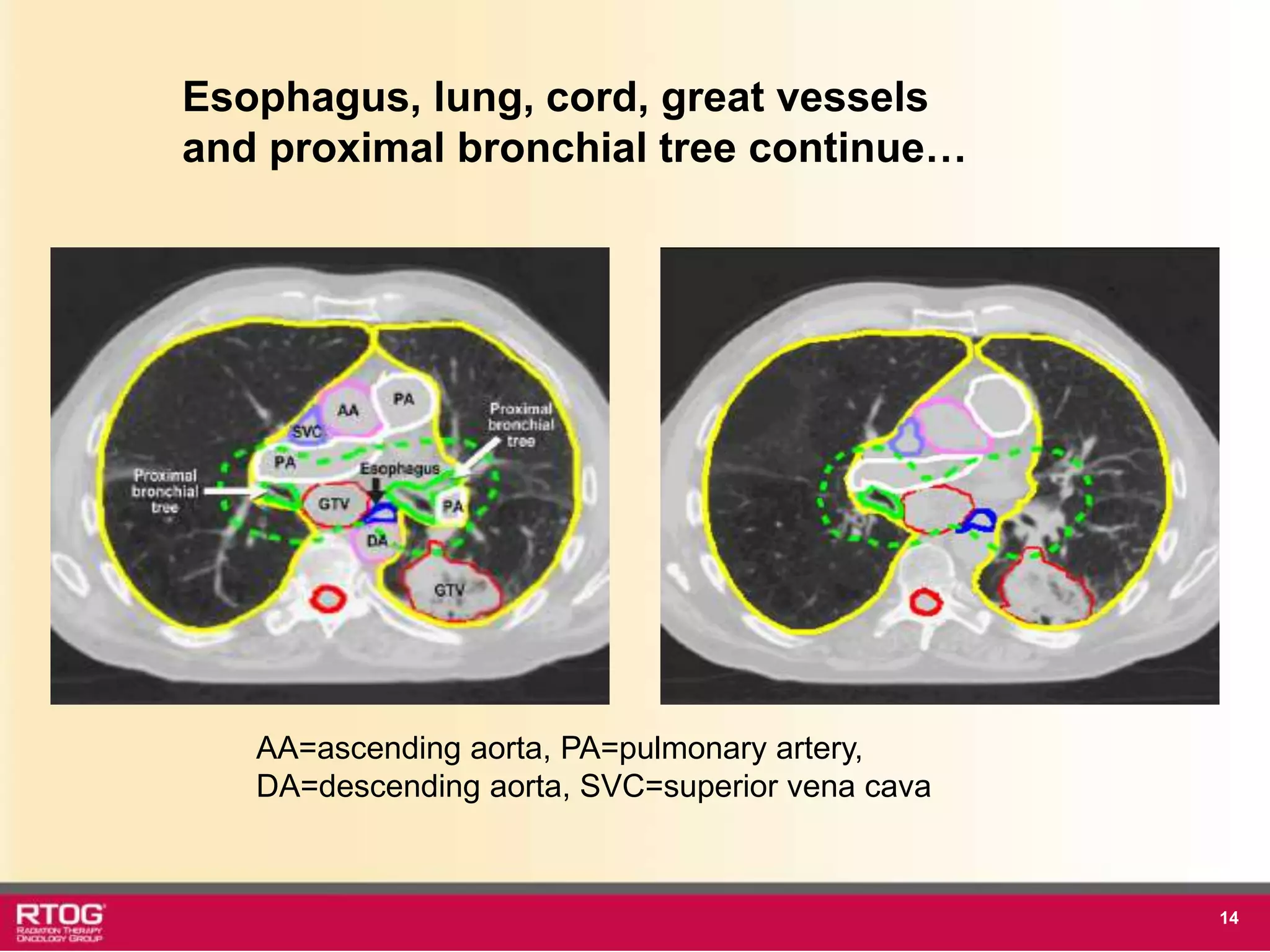 RTOG 1106 OAR Atlas Thoracic Radiation Therapy.ppt