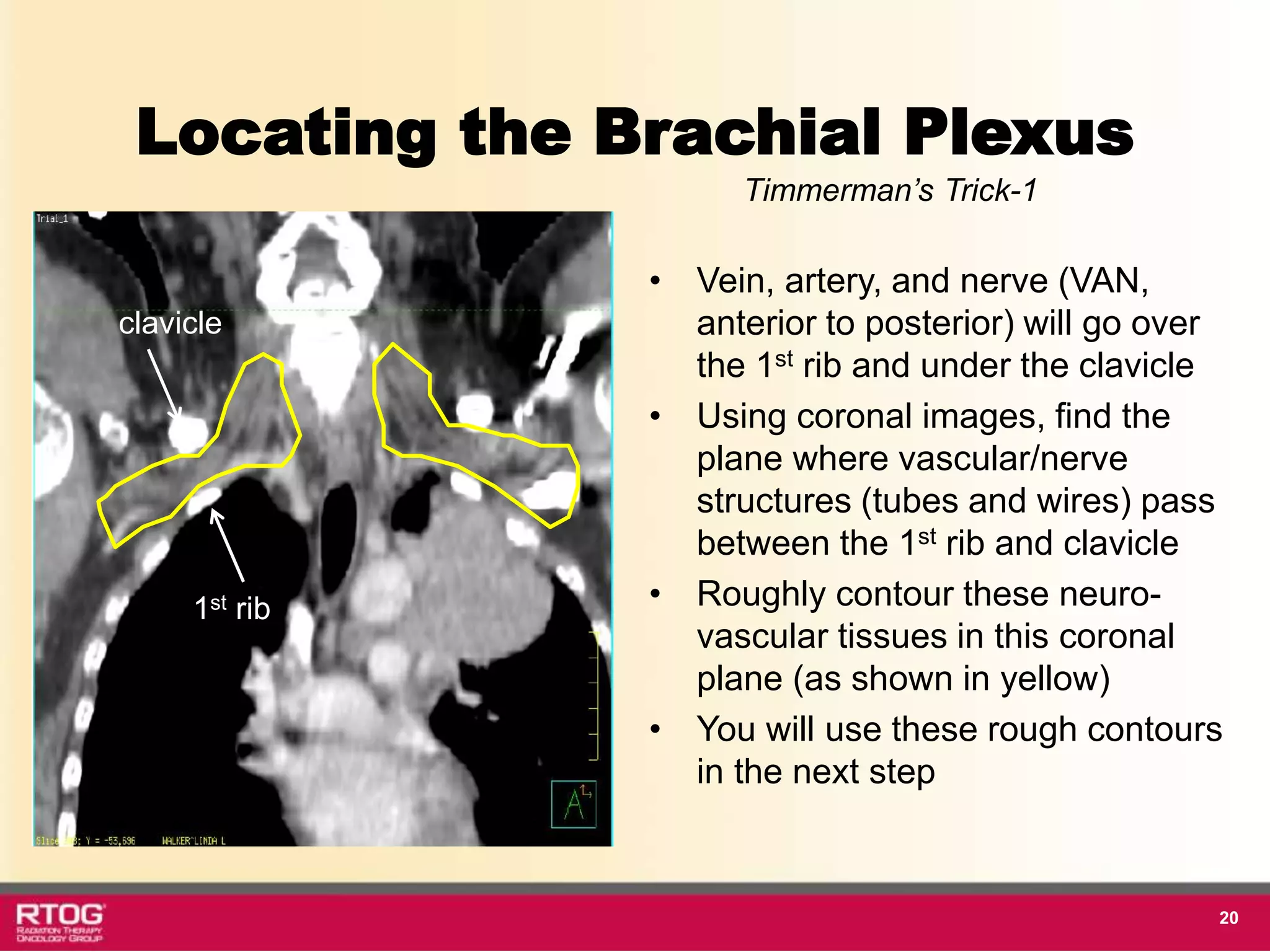RTOG 1106 OAR Atlas Thoracic Radiation Therapy.ppt
