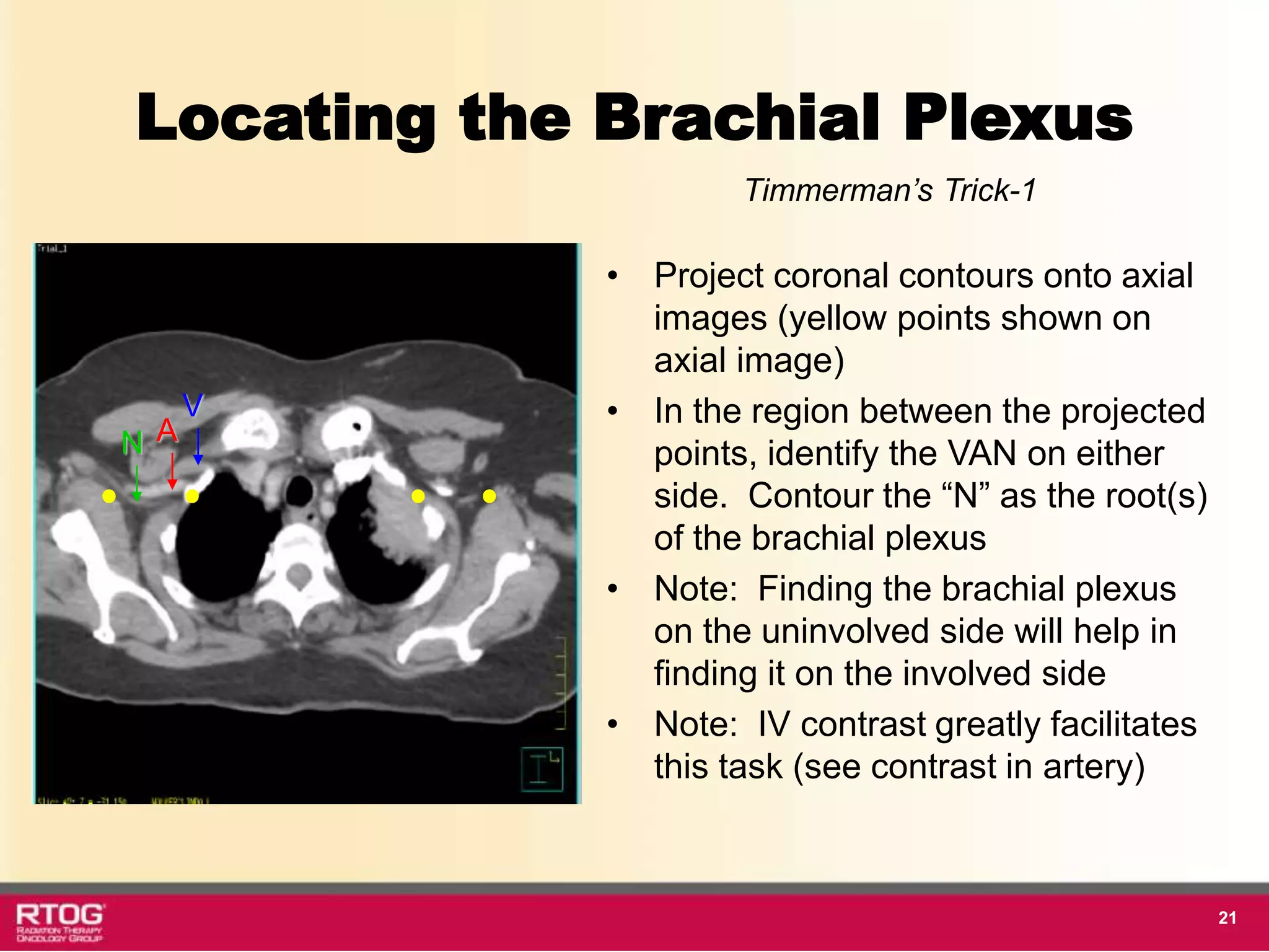 RTOG 1106 OAR Atlas Thoracic Radiation Therapy.ppt