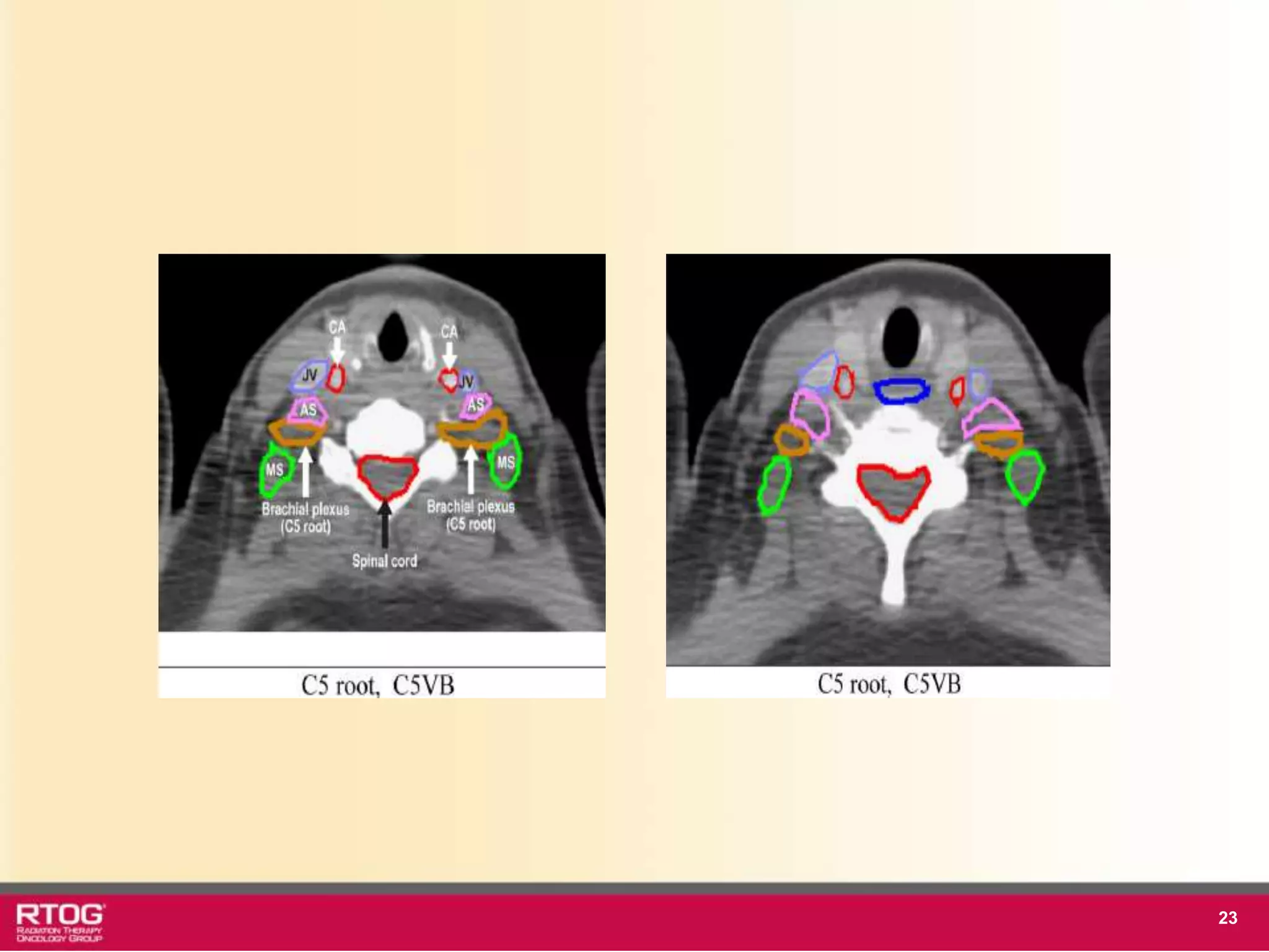 RTOG 1106 OAR Atlas Thoracic Radiation Therapy.ppt
