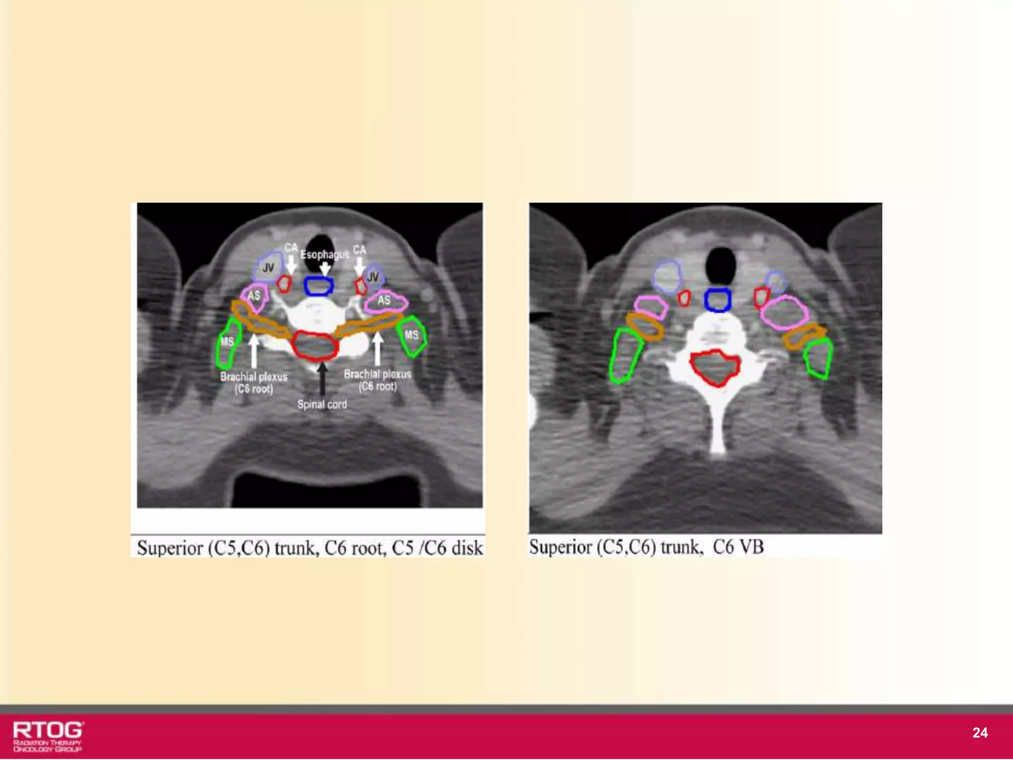 RTOG 1106 OAR Atlas Thoracic Radiation Therapy.ppt