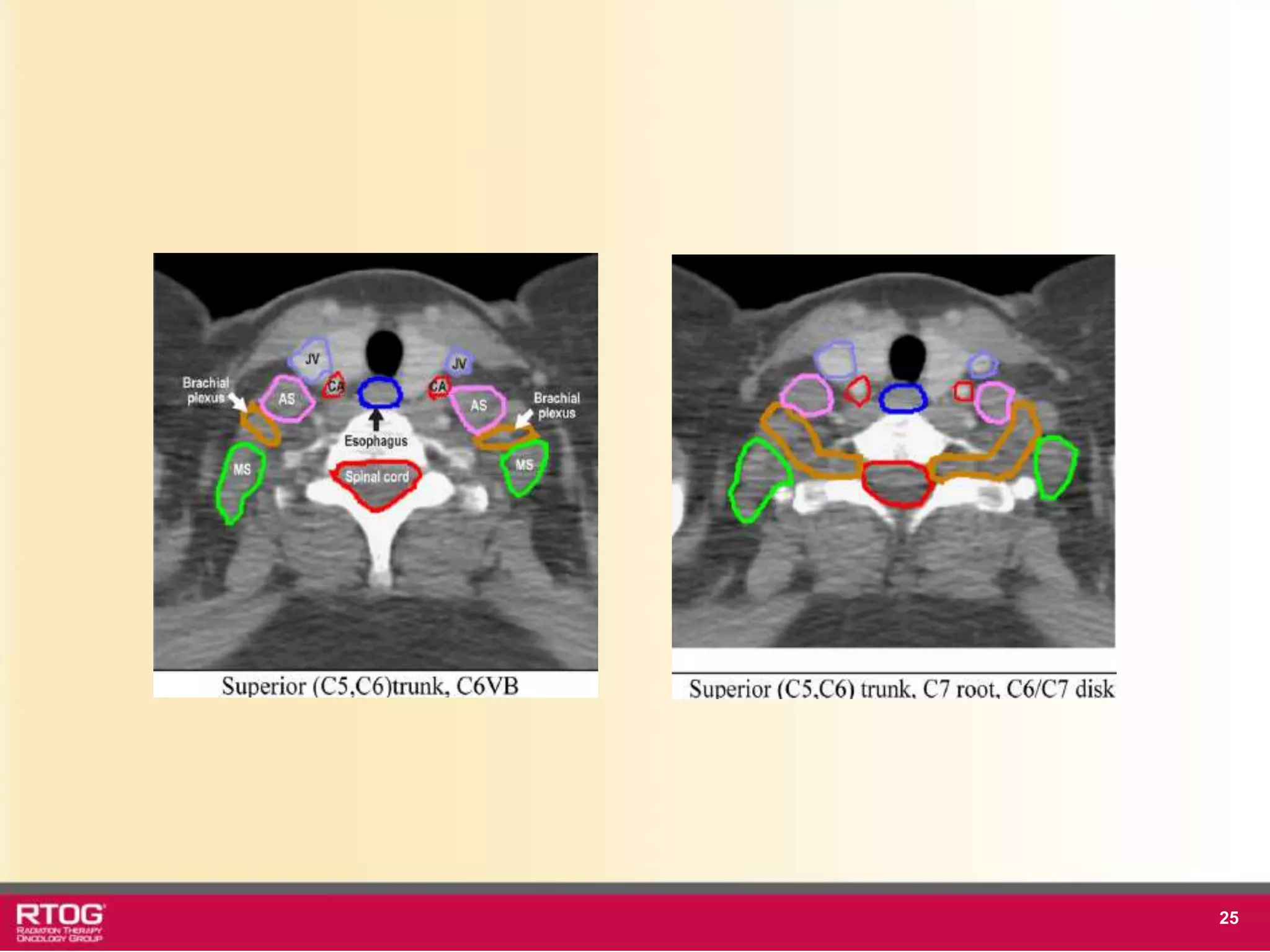 RTOG 1106 OAR Atlas Thoracic Radiation Therapy.ppt