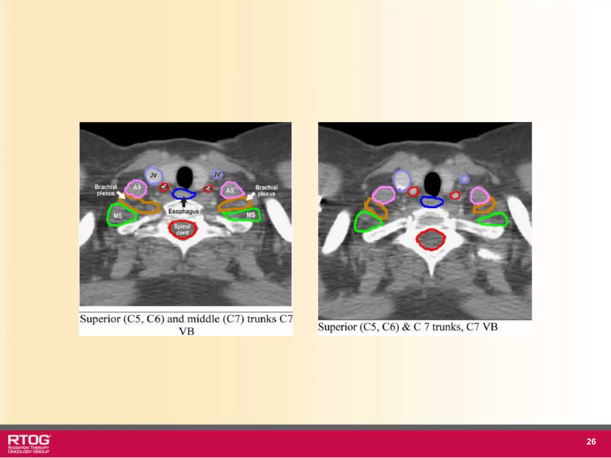 RTOG 1106 OAR Atlas Thoracic Radiation Therapy.ppt