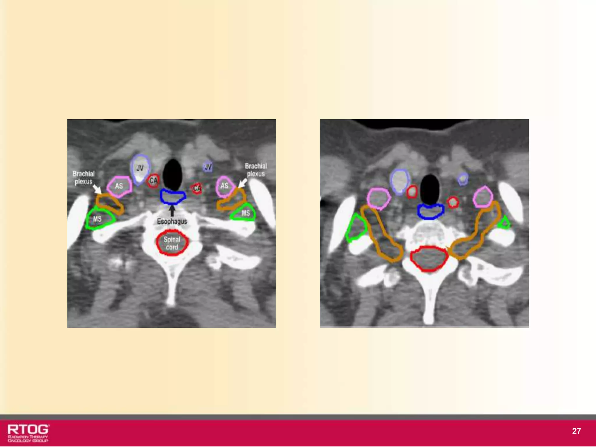 RTOG 1106 OAR Atlas Thoracic Radiation Therapy.ppt