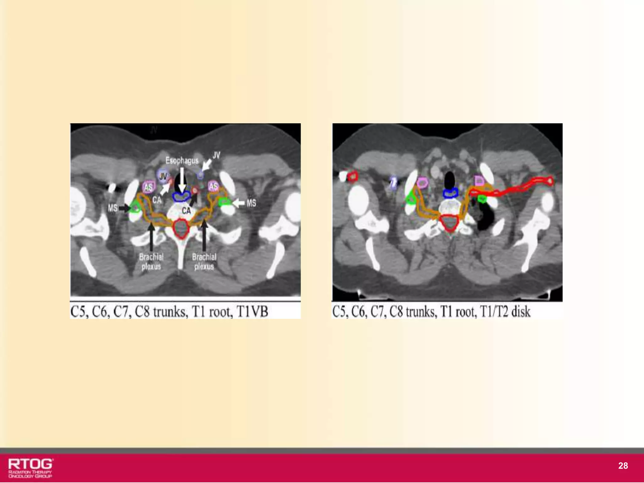 RTOG 1106 OAR Atlas Thoracic Radiation Therapy.ppt