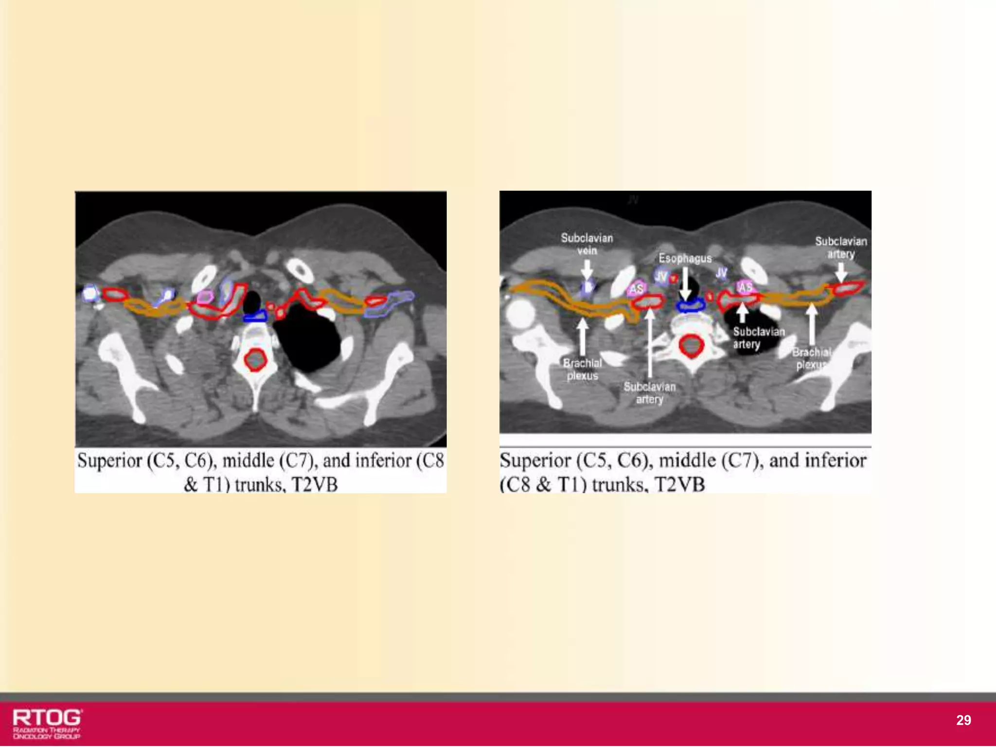 RTOG 1106 OAR Atlas Thoracic Radiation Therapy.ppt