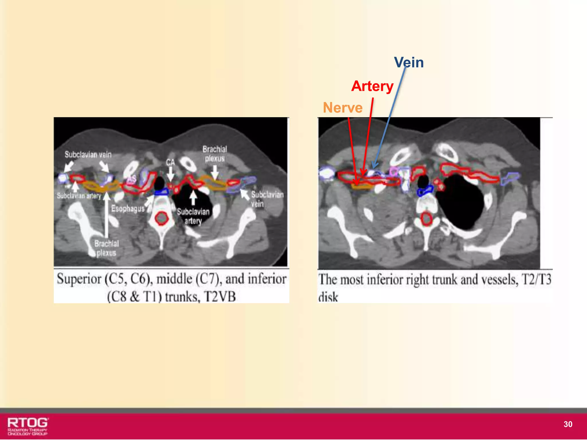 RTOG 1106 OAR Atlas Thoracic Radiation Therapy.ppt