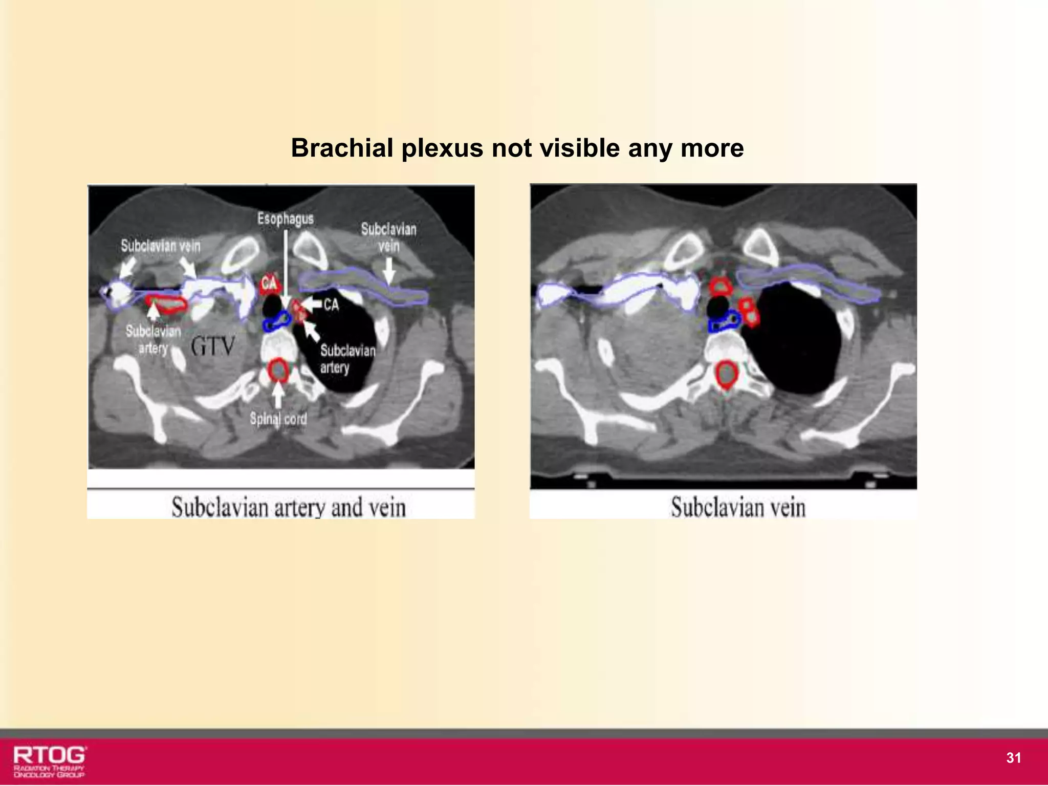 RTOG 1106 OAR Atlas Thoracic Radiation Therapy.ppt