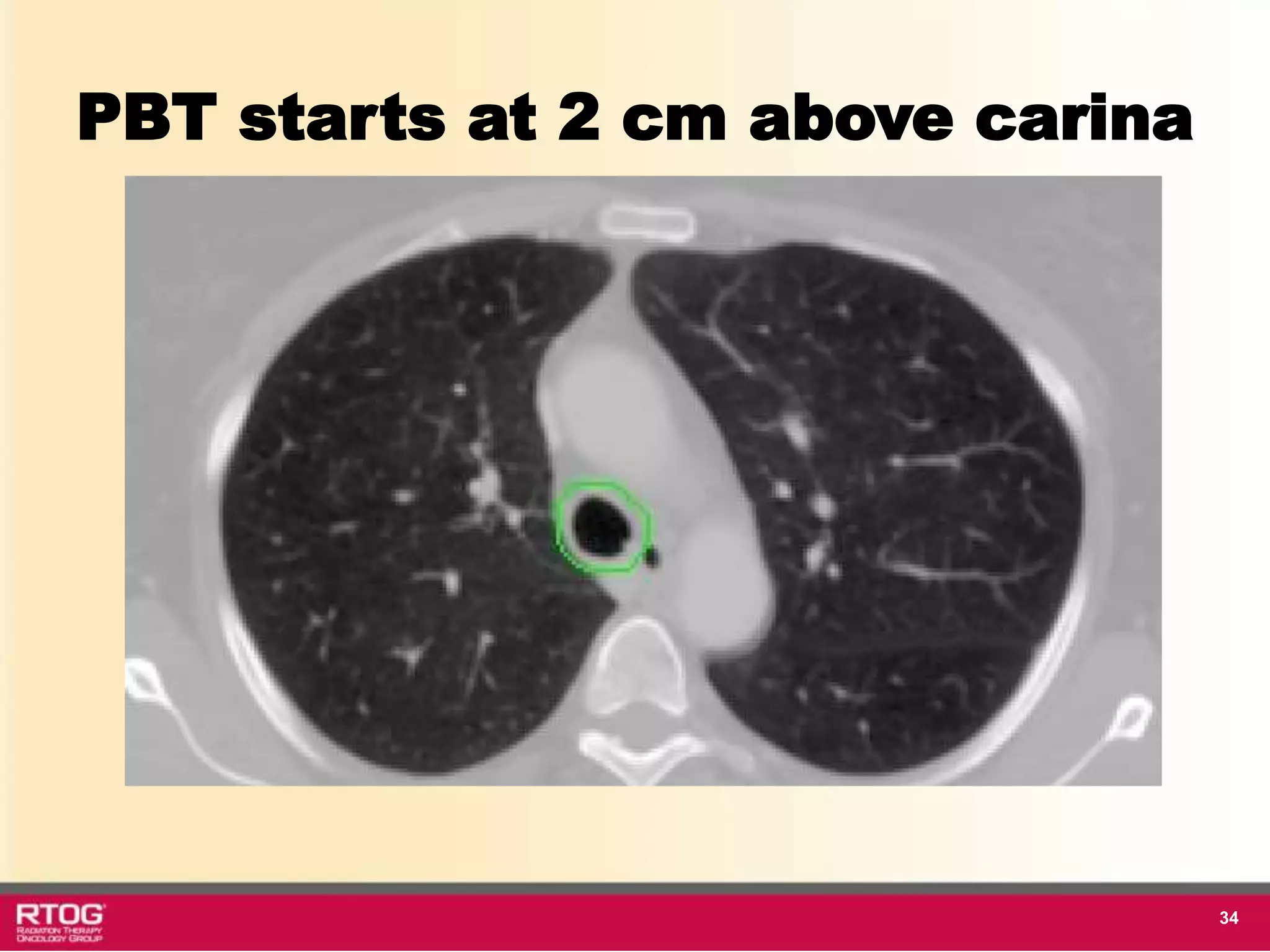 RTOG 1106 OAR Atlas Thoracic Radiation Therapy.ppt