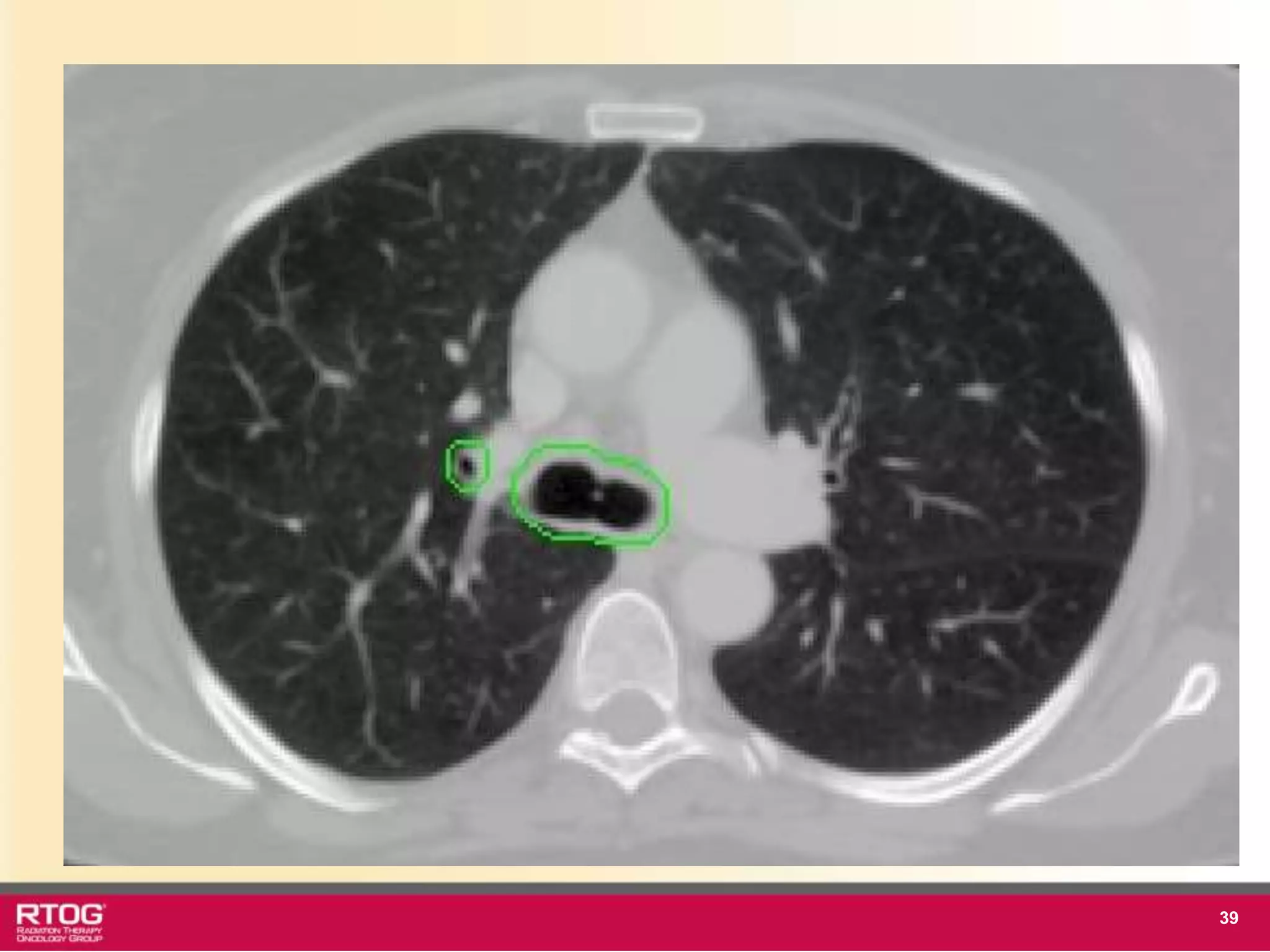 RTOG 1106 OAR Atlas Thoracic Radiation Therapy.ppt