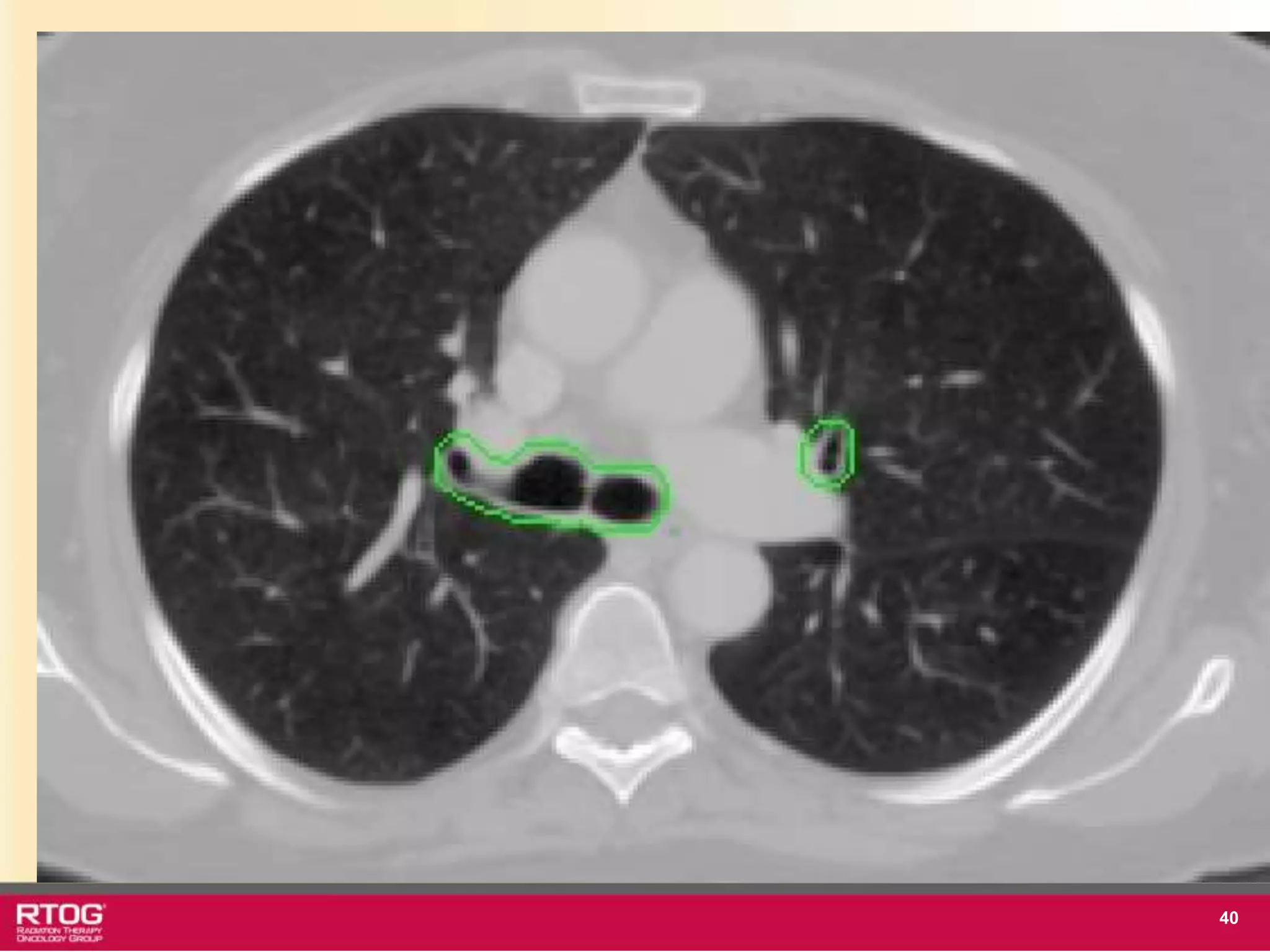 RTOG 1106 OAR Atlas Thoracic Radiation Therapy.ppt