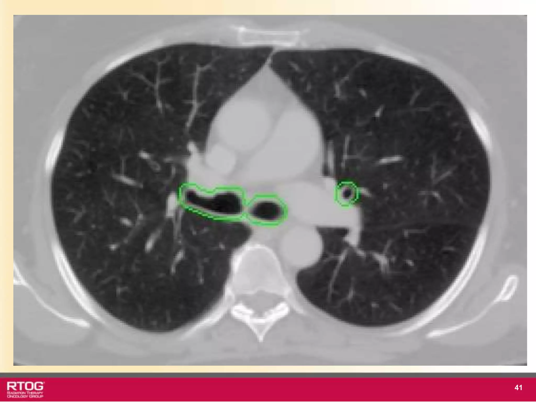 RTOG 1106 OAR Atlas Thoracic Radiation Therapy.ppt