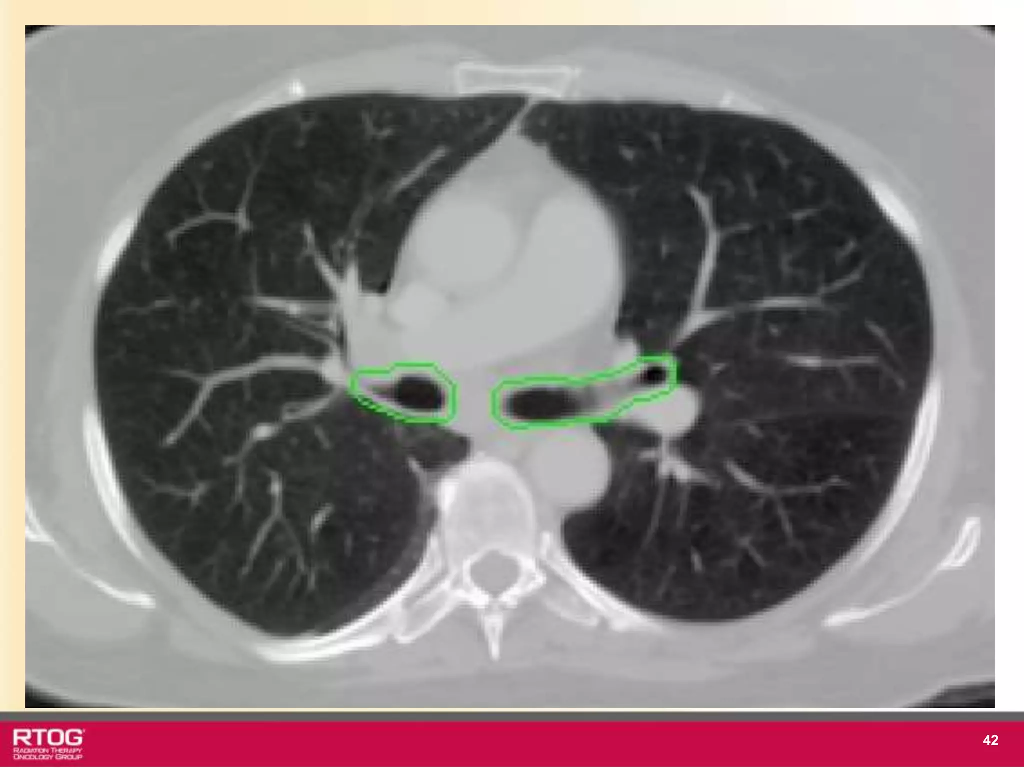 RTOG 1106 OAR Atlas Thoracic Radiation Therapy.ppt