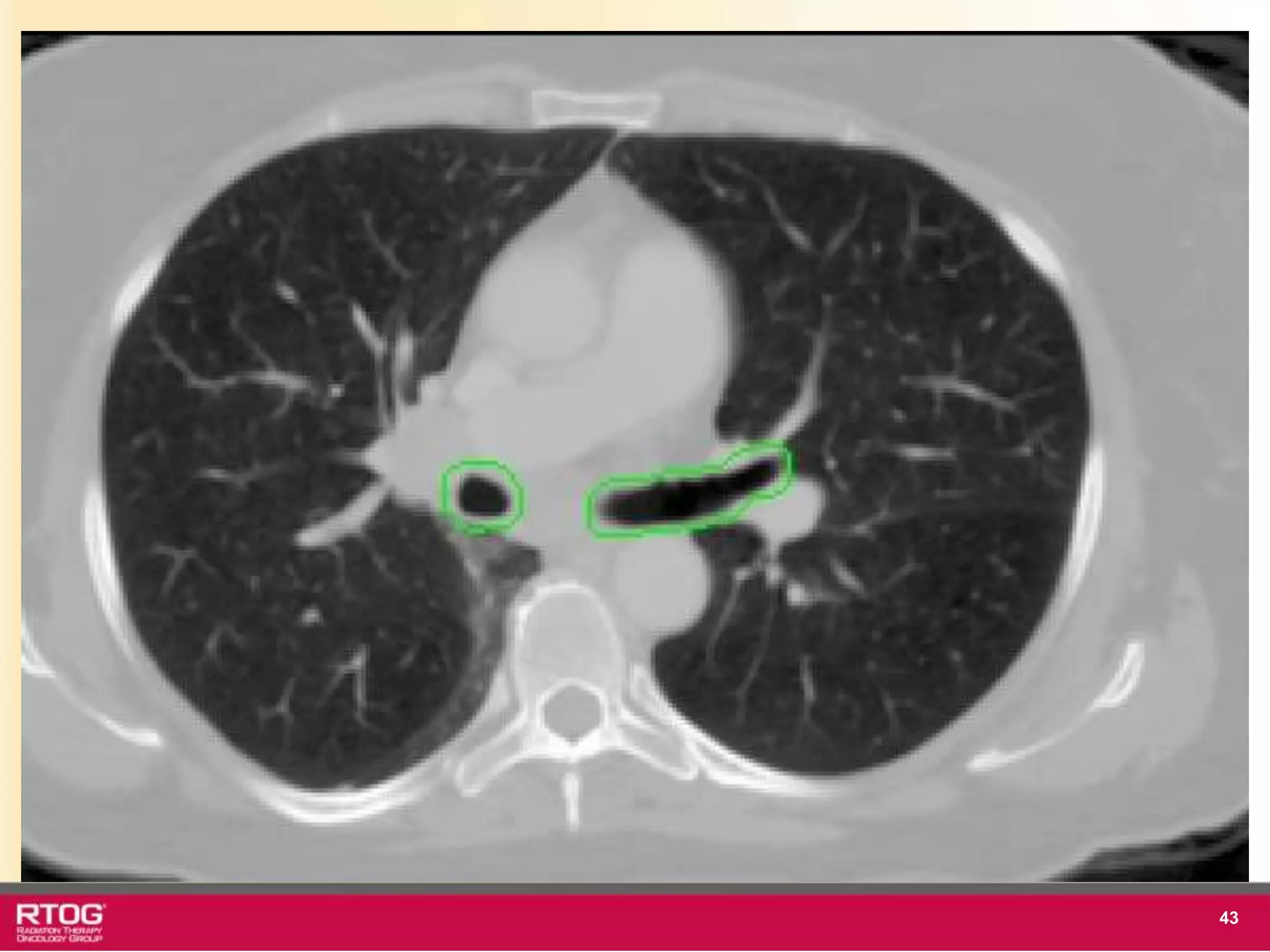 RTOG 1106 OAR Atlas Thoracic Radiation Therapy.ppt
