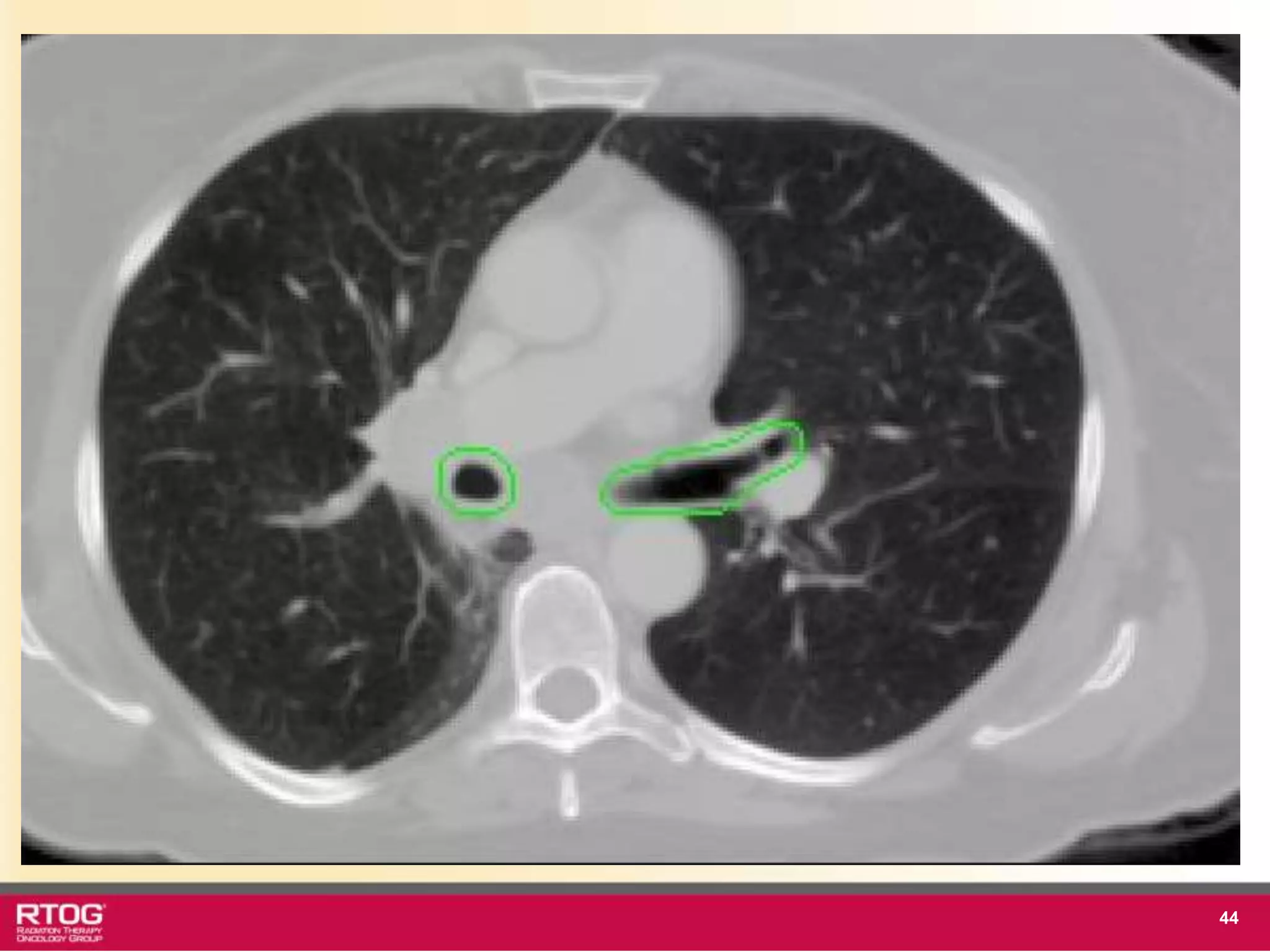 RTOG 1106 OAR Atlas Thoracic Radiation Therapy.ppt