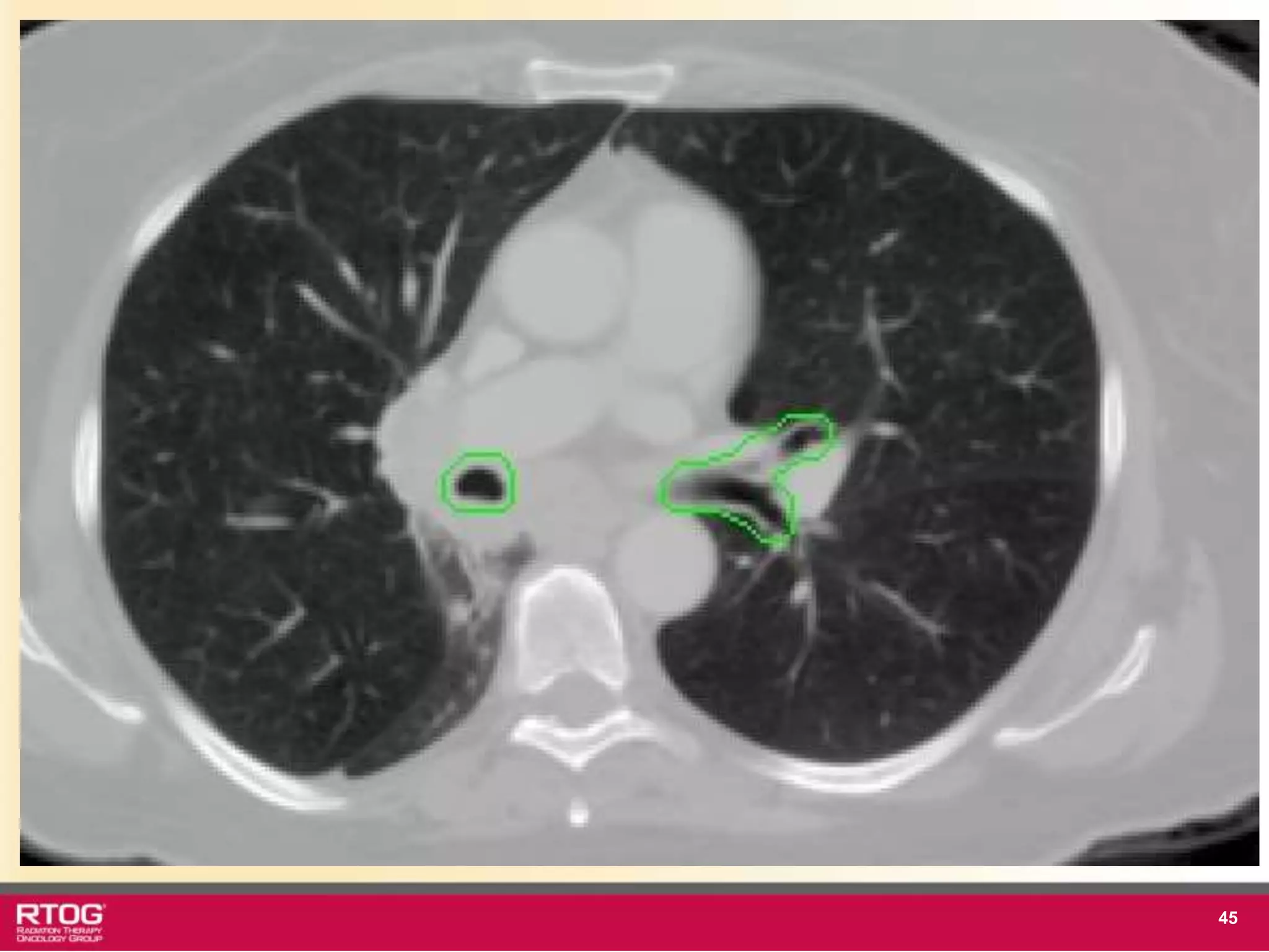 RTOG 1106 OAR Atlas Thoracic Radiation Therapy.ppt