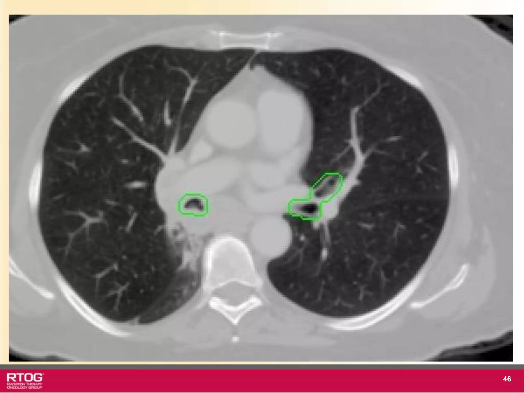 RTOG 1106 OAR Atlas Thoracic Radiation Therapy.ppt