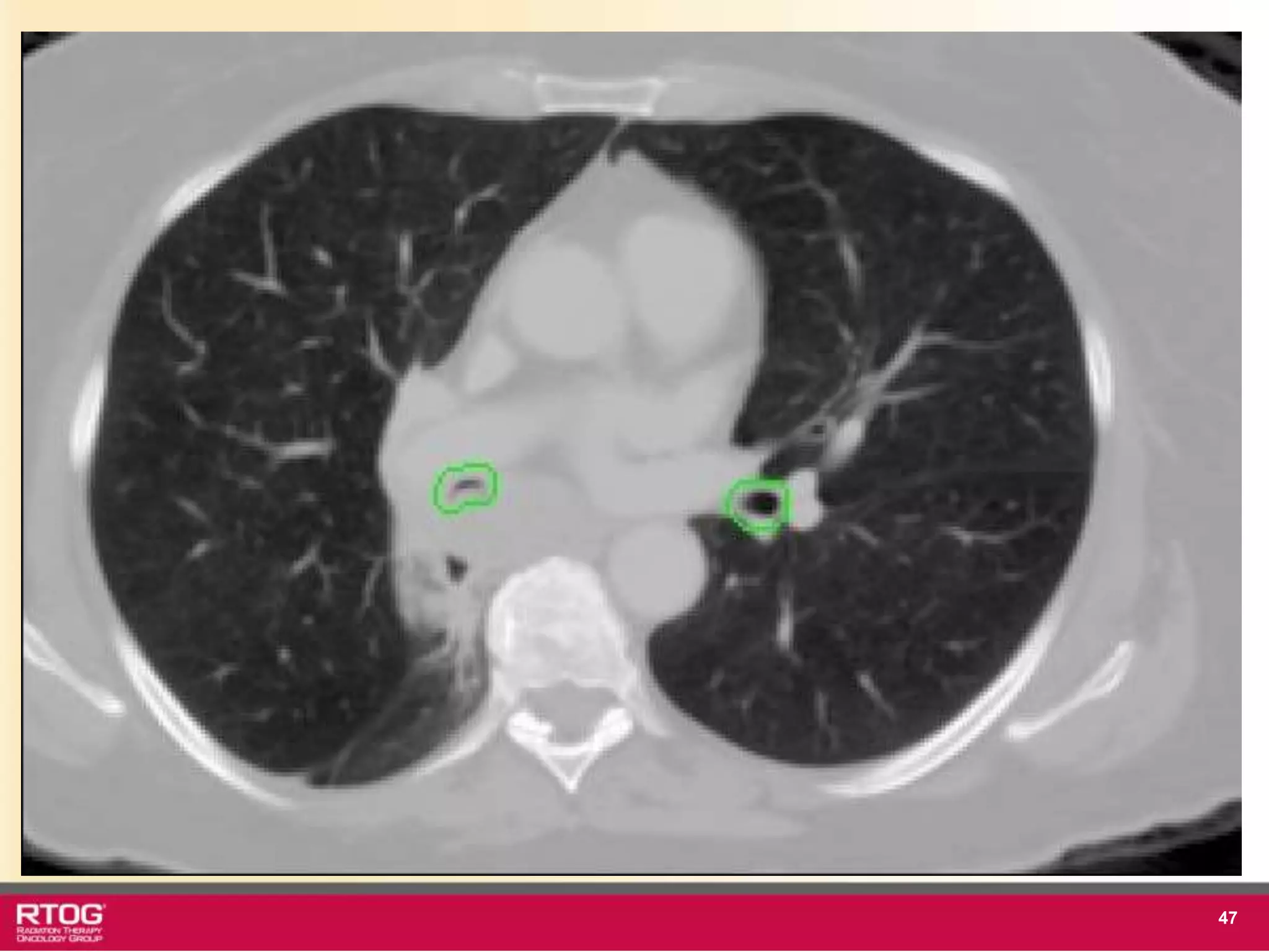 RTOG 1106 OAR Atlas Thoracic Radiation Therapy.ppt