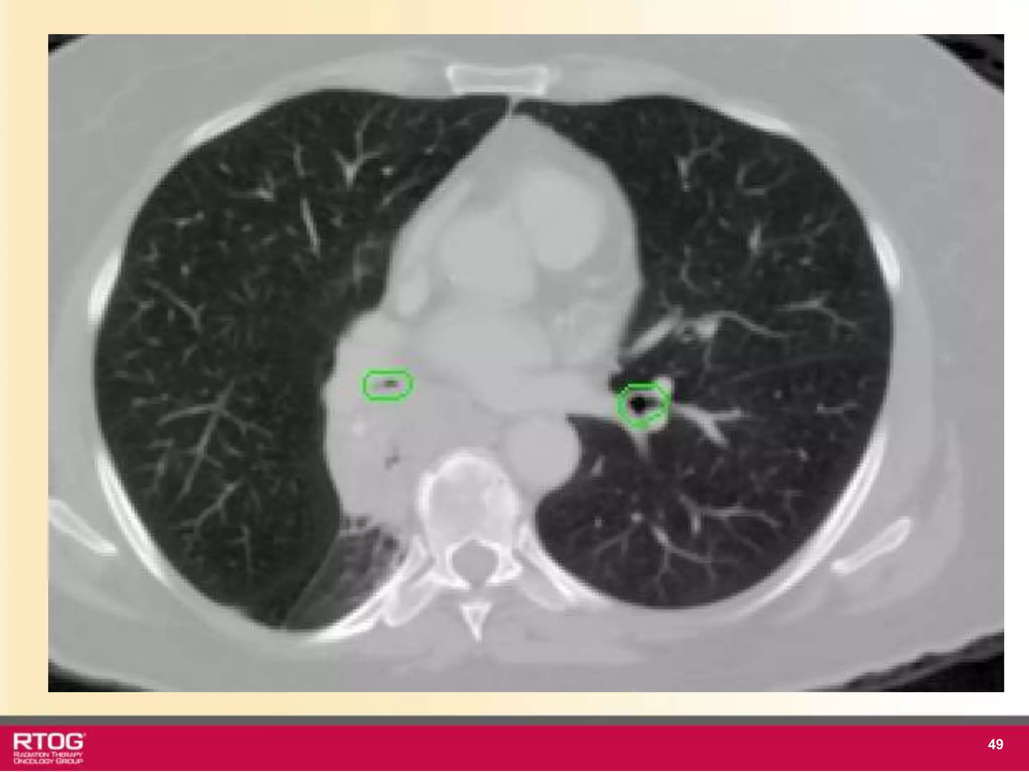 RTOG 1106 OAR Atlas Thoracic Radiation Therapy.ppt