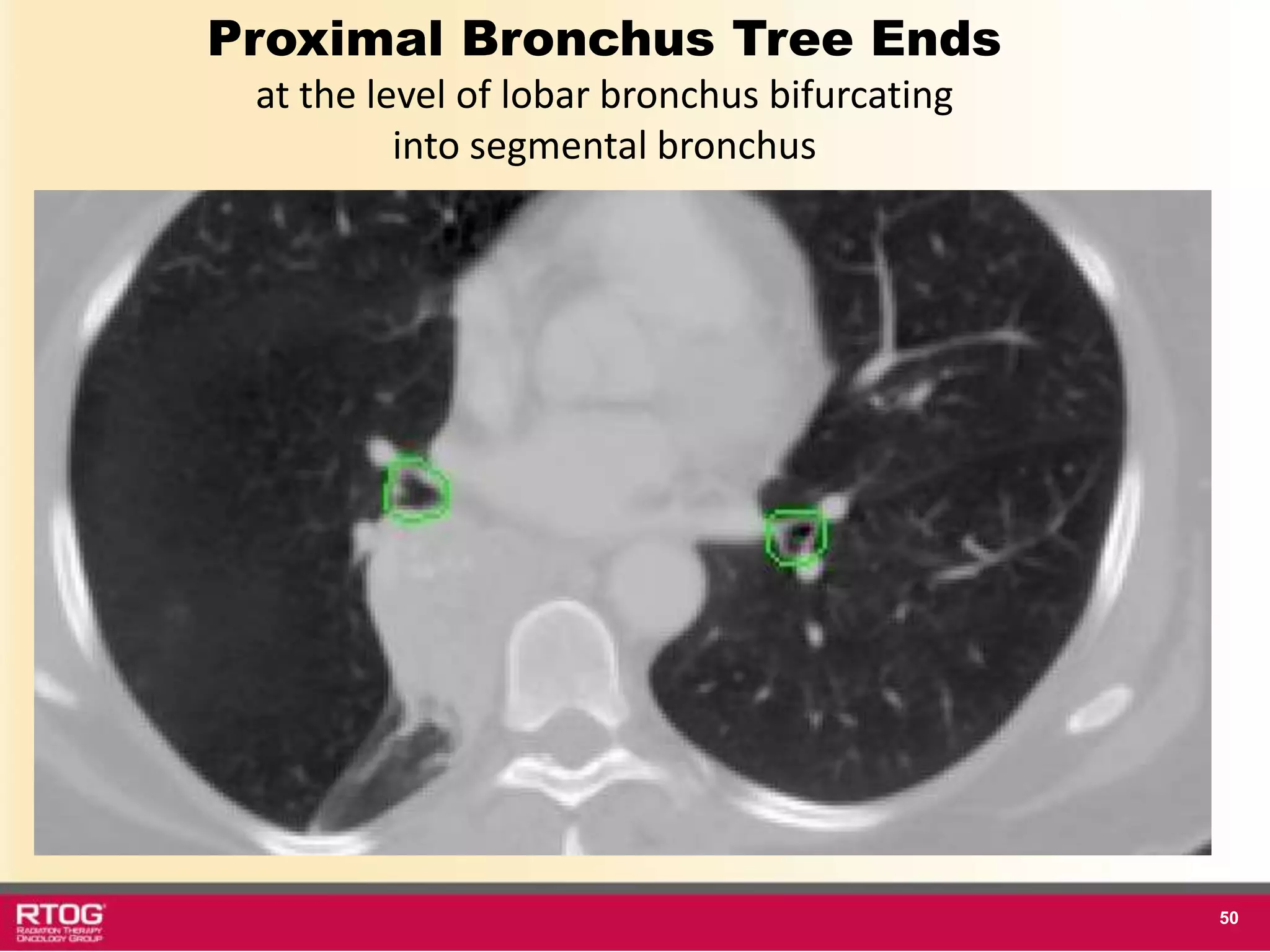 RTOG 1106 OAR Atlas Thoracic Radiation Therapy.ppt