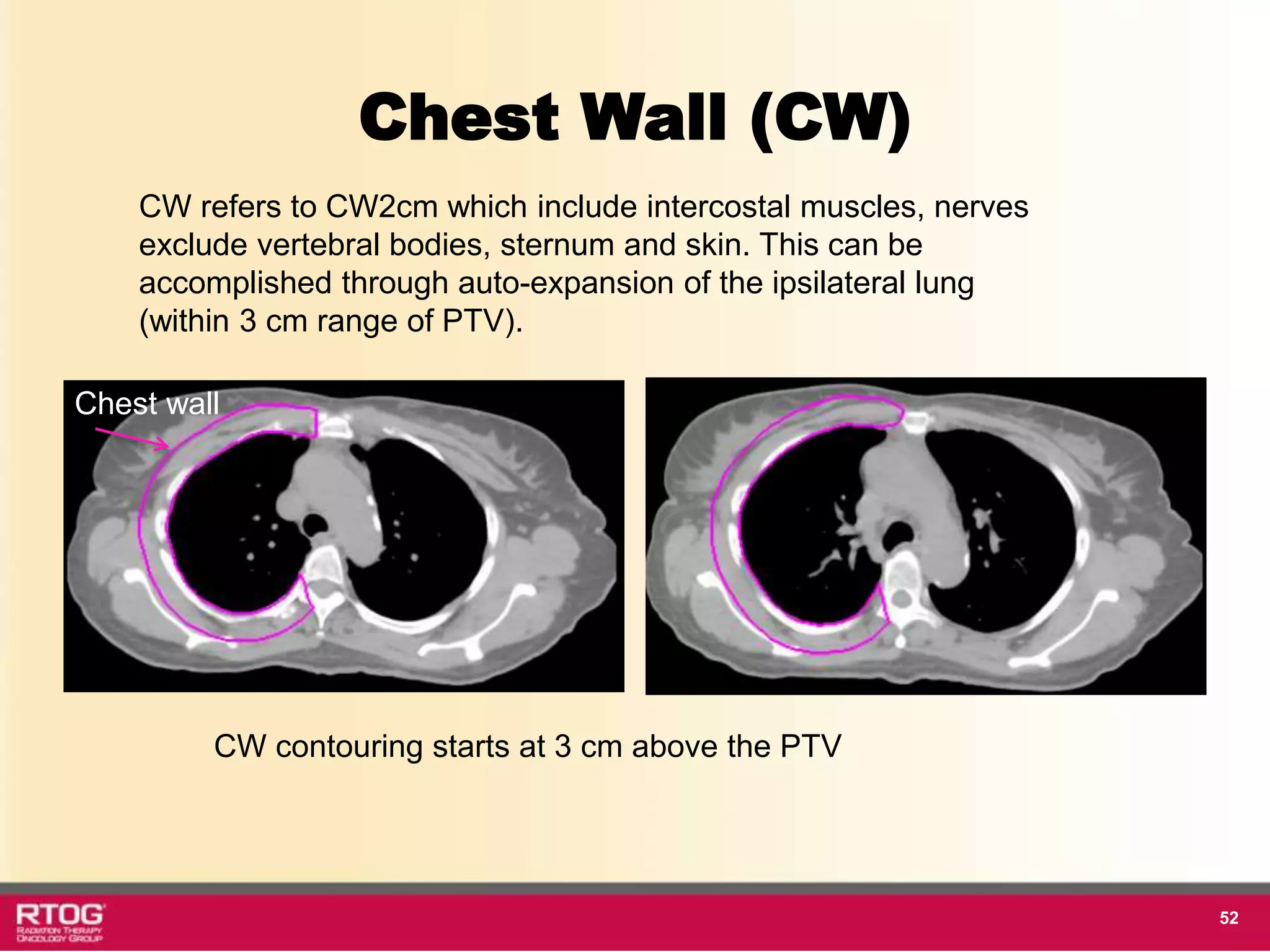 RTOG 1106 OAR Atlas Thoracic Radiation Therapy.ppt