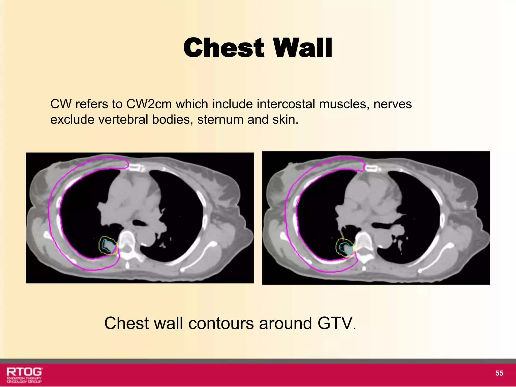 RTOG 1106 OAR Atlas Thoracic Radiation Therapy.ppt