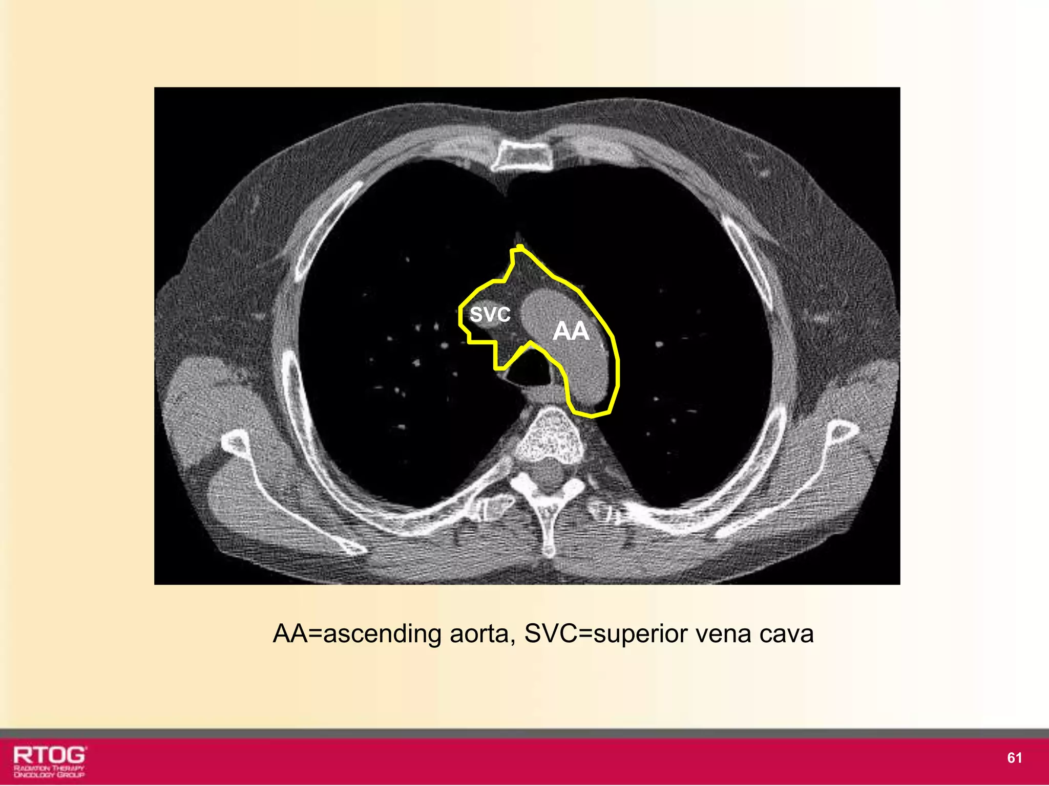 RTOG 1106 OAR Atlas Thoracic Radiation Therapy.ppt