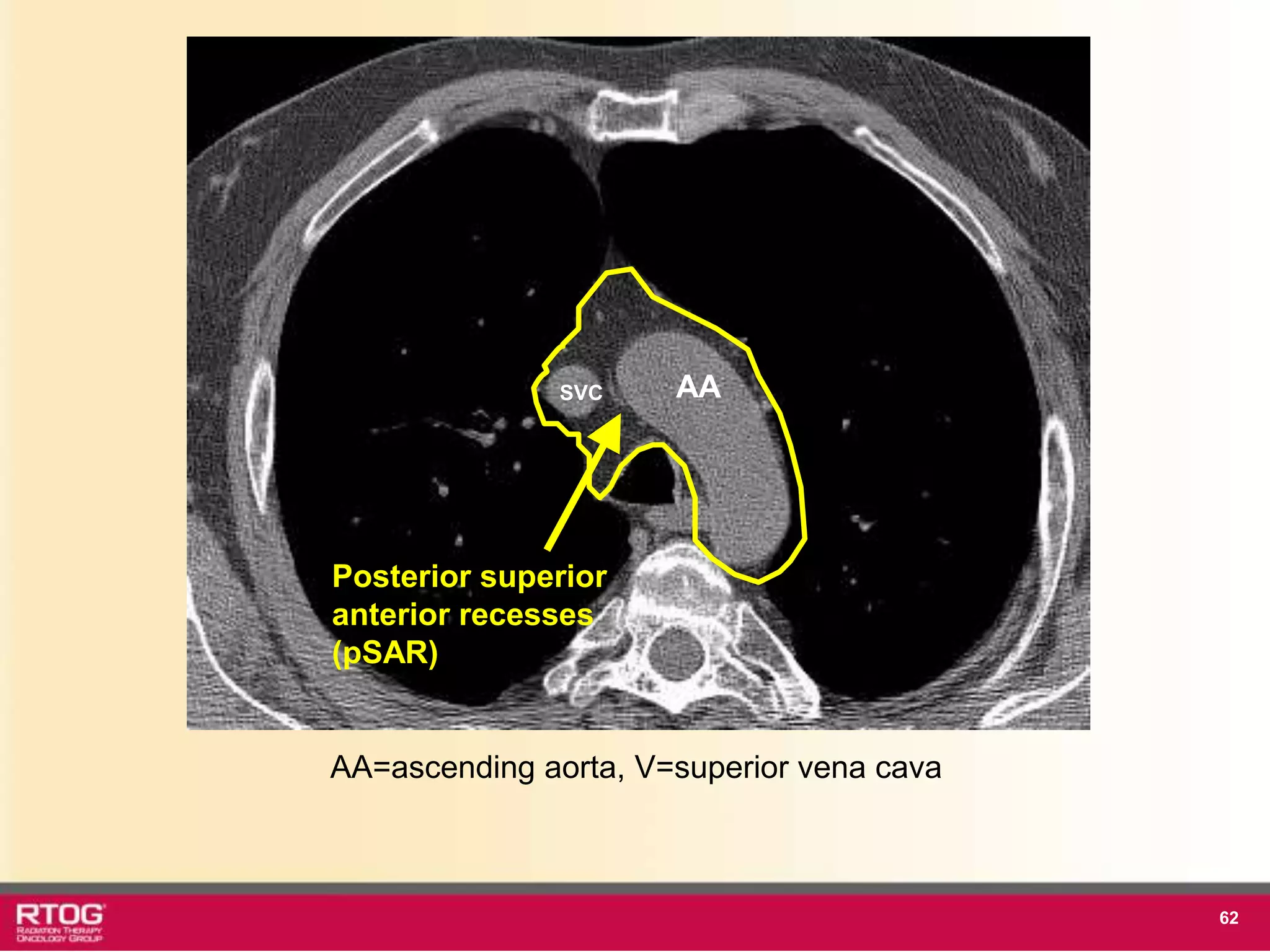 RTOG 1106 OAR Atlas Thoracic Radiation Therapy.ppt