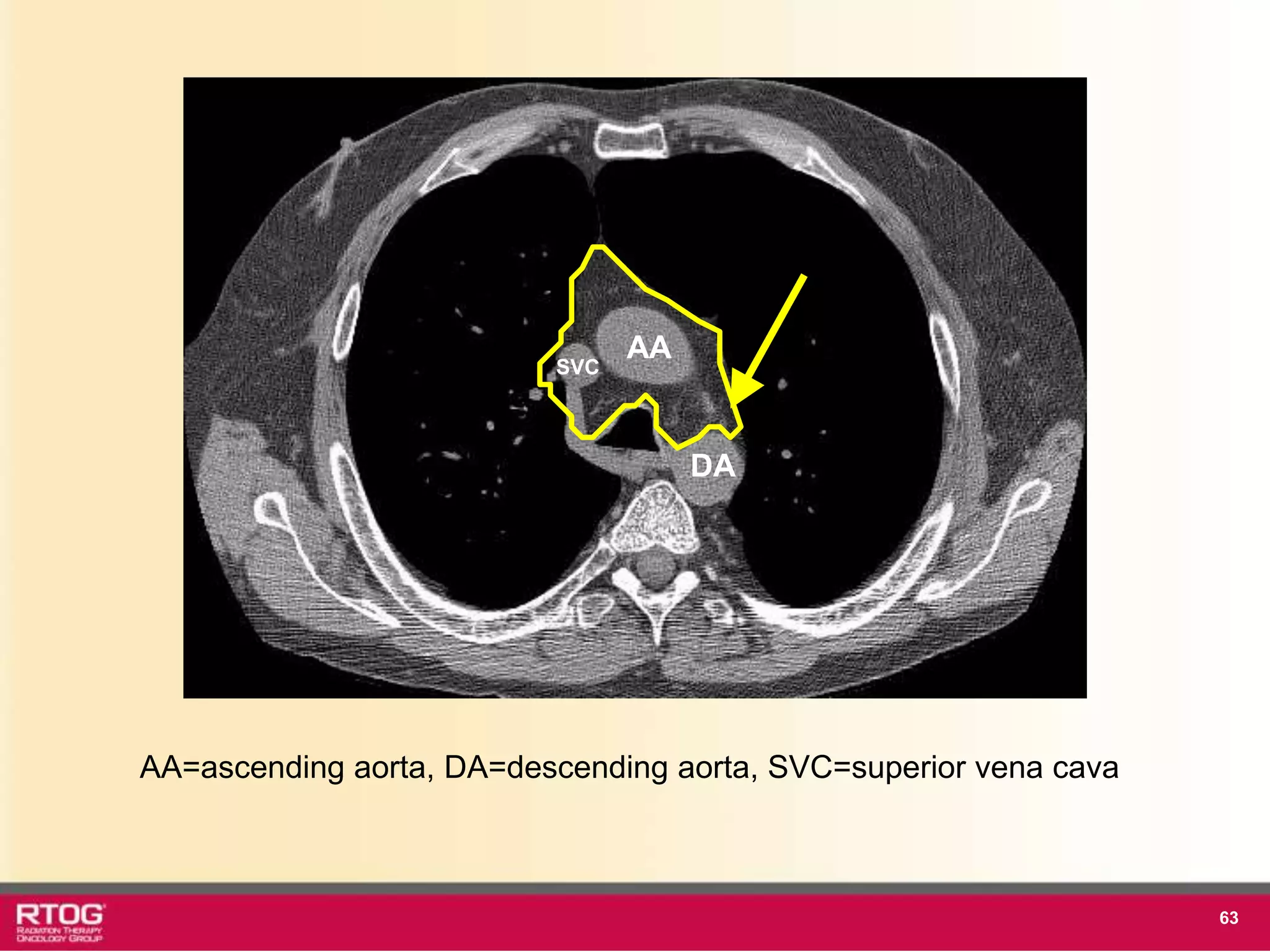RTOG 1106 OAR Atlas Thoracic Radiation Therapy.ppt
