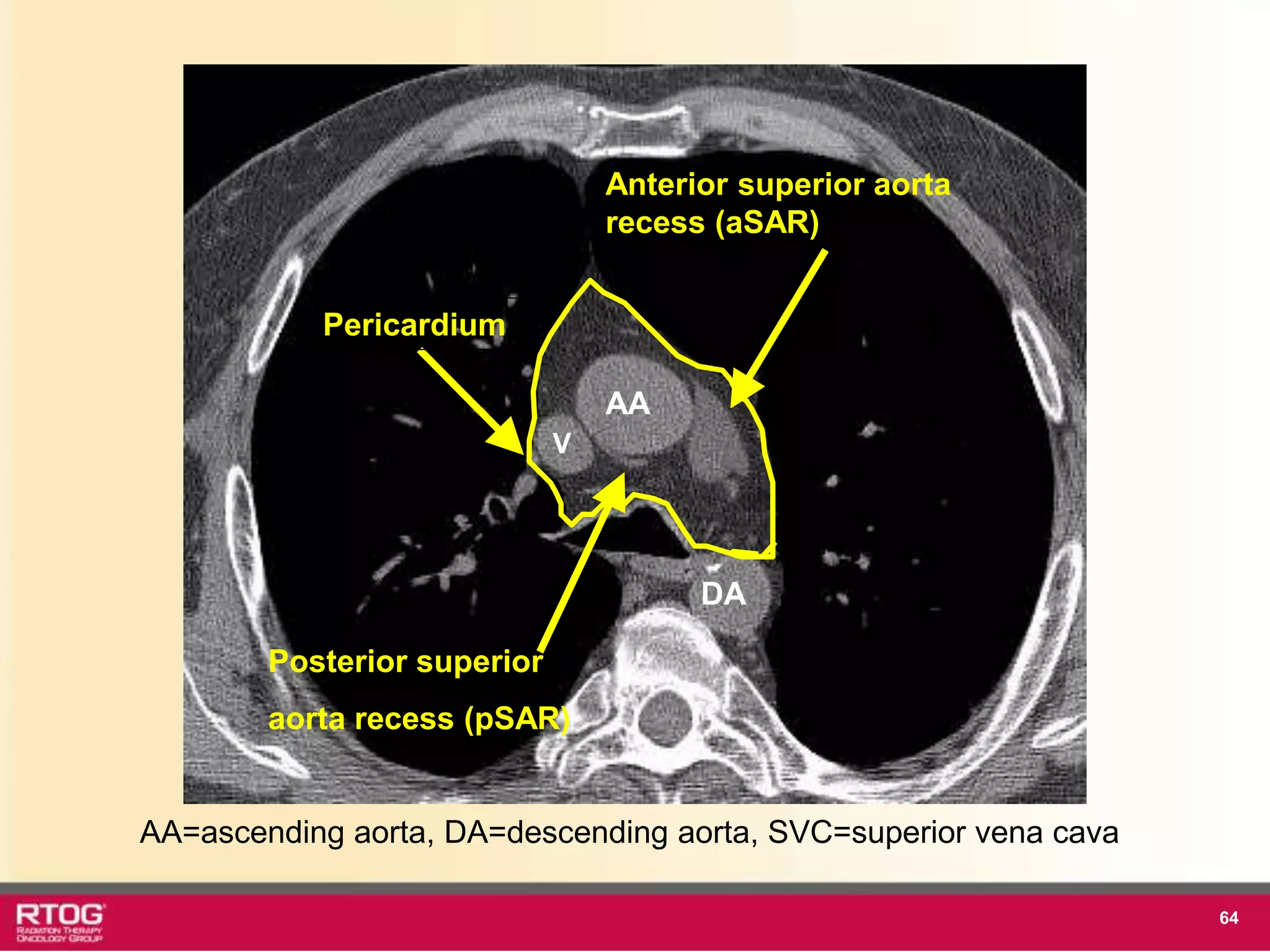 RTOG 1106 OAR Atlas Thoracic Radiation Therapy.ppt