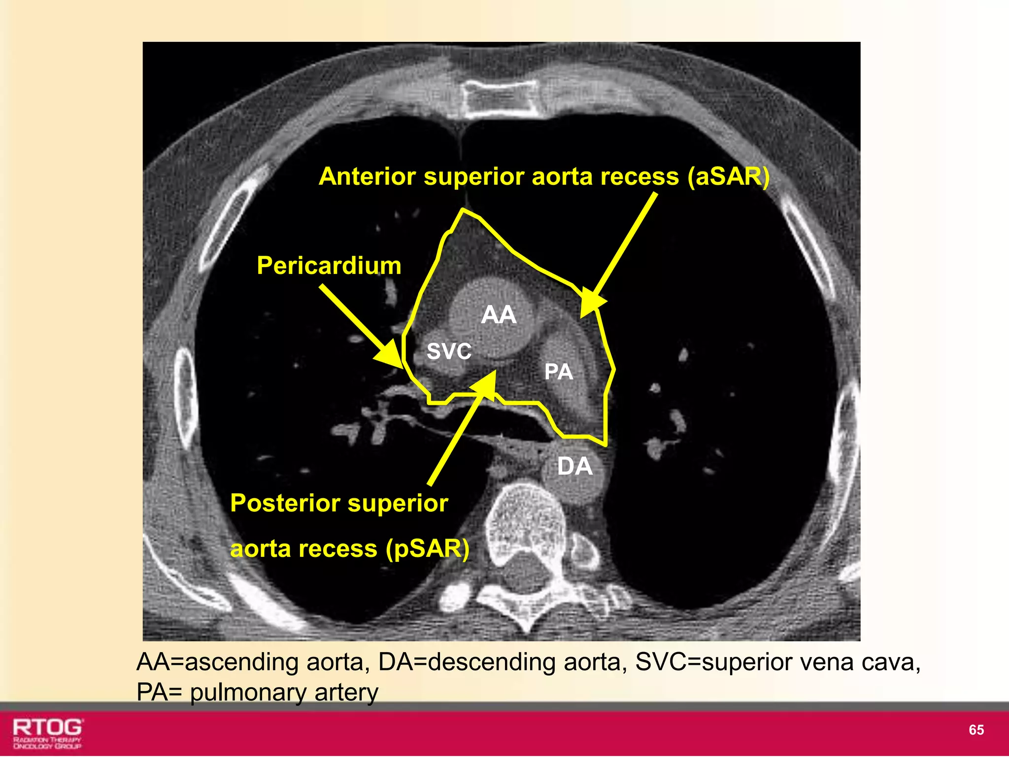 RTOG 1106 OAR Atlas Thoracic Radiation Therapy.ppt