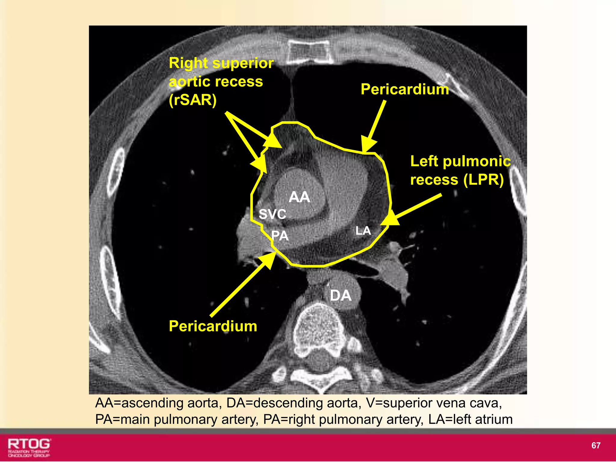 RTOG 1106 OAR Atlas Thoracic Radiation Therapy.ppt