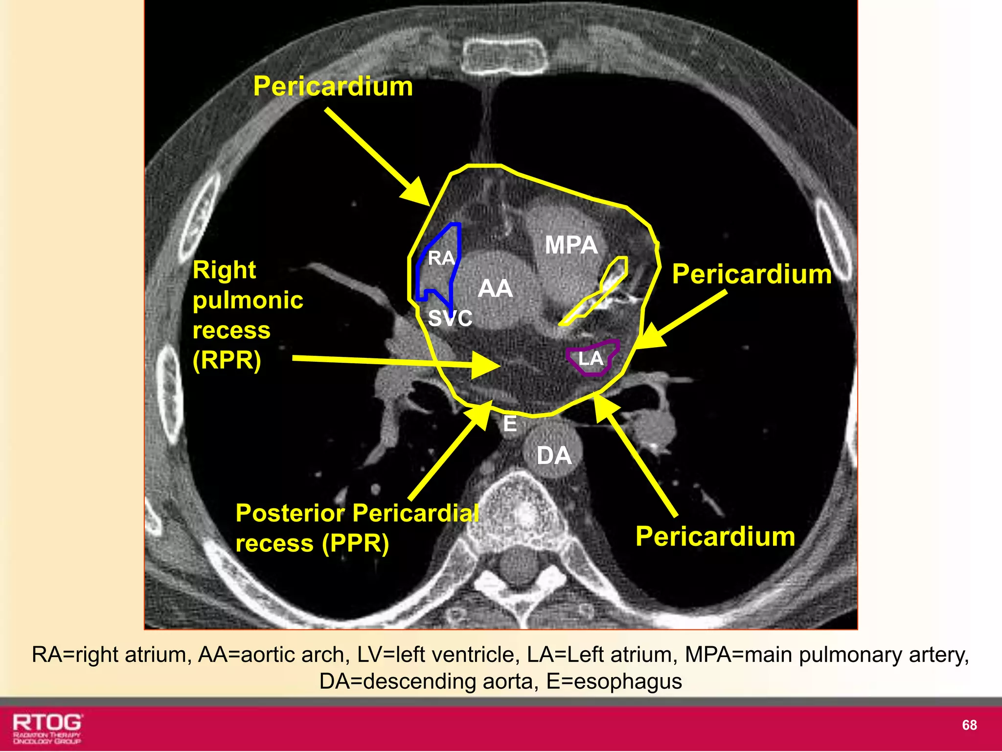 RTOG 1106 OAR Atlas Thoracic Radiation Therapy.ppt
